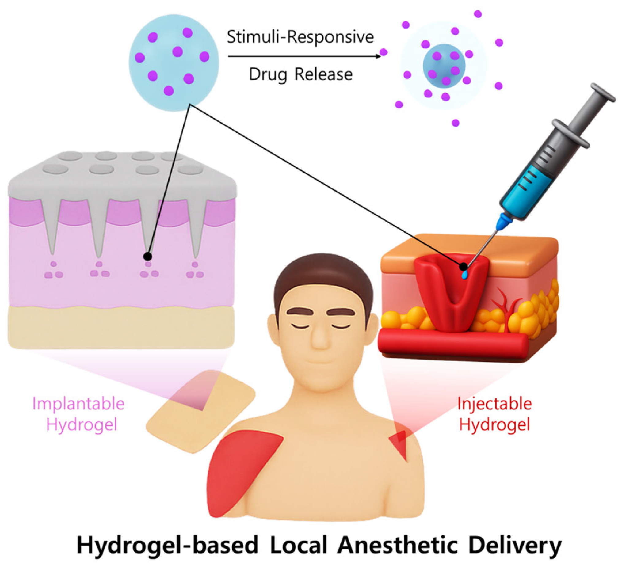 Hydrogel Drug Delivery Systems and Liposomal Bupivacaine: Innovations ...