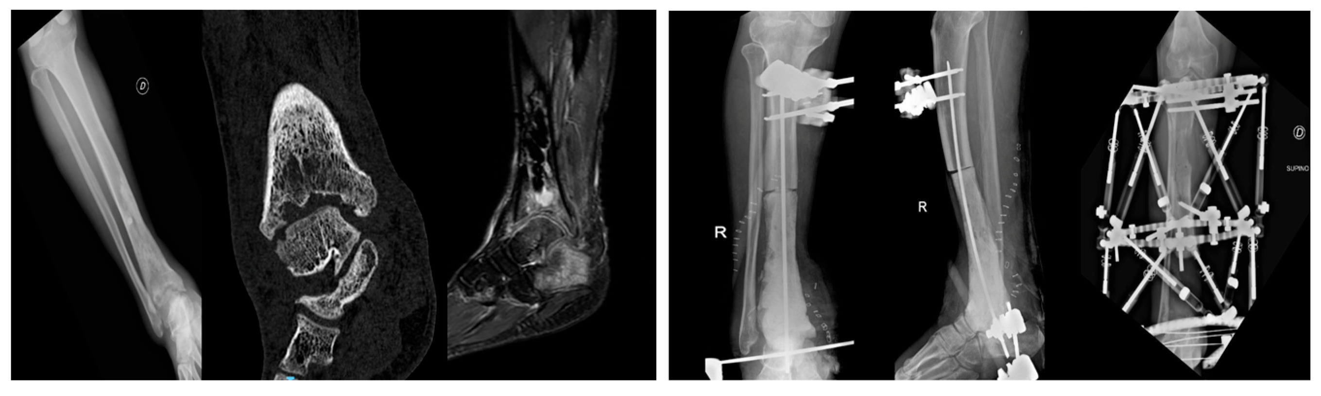 Management and Treatment Strategies for Distal Tibia and Ankle ...