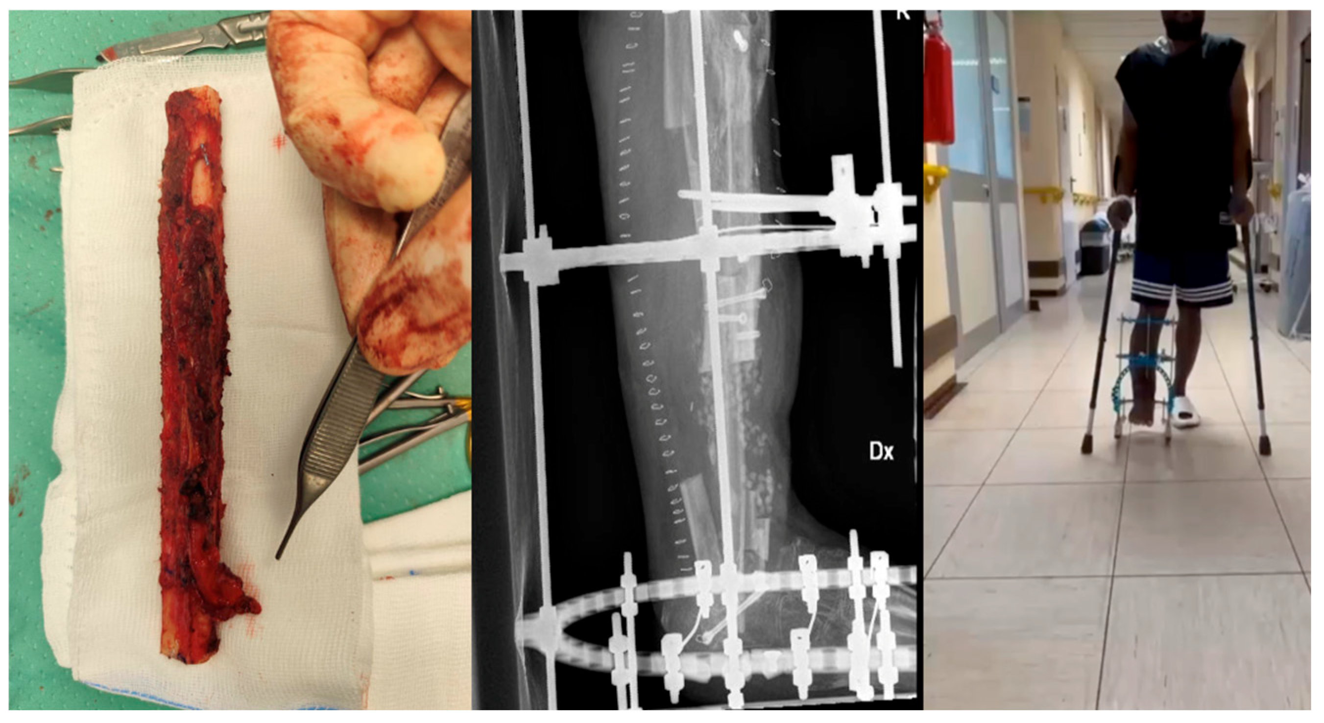 Management and Treatment Strategies for Distal Tibia and Ankle ...