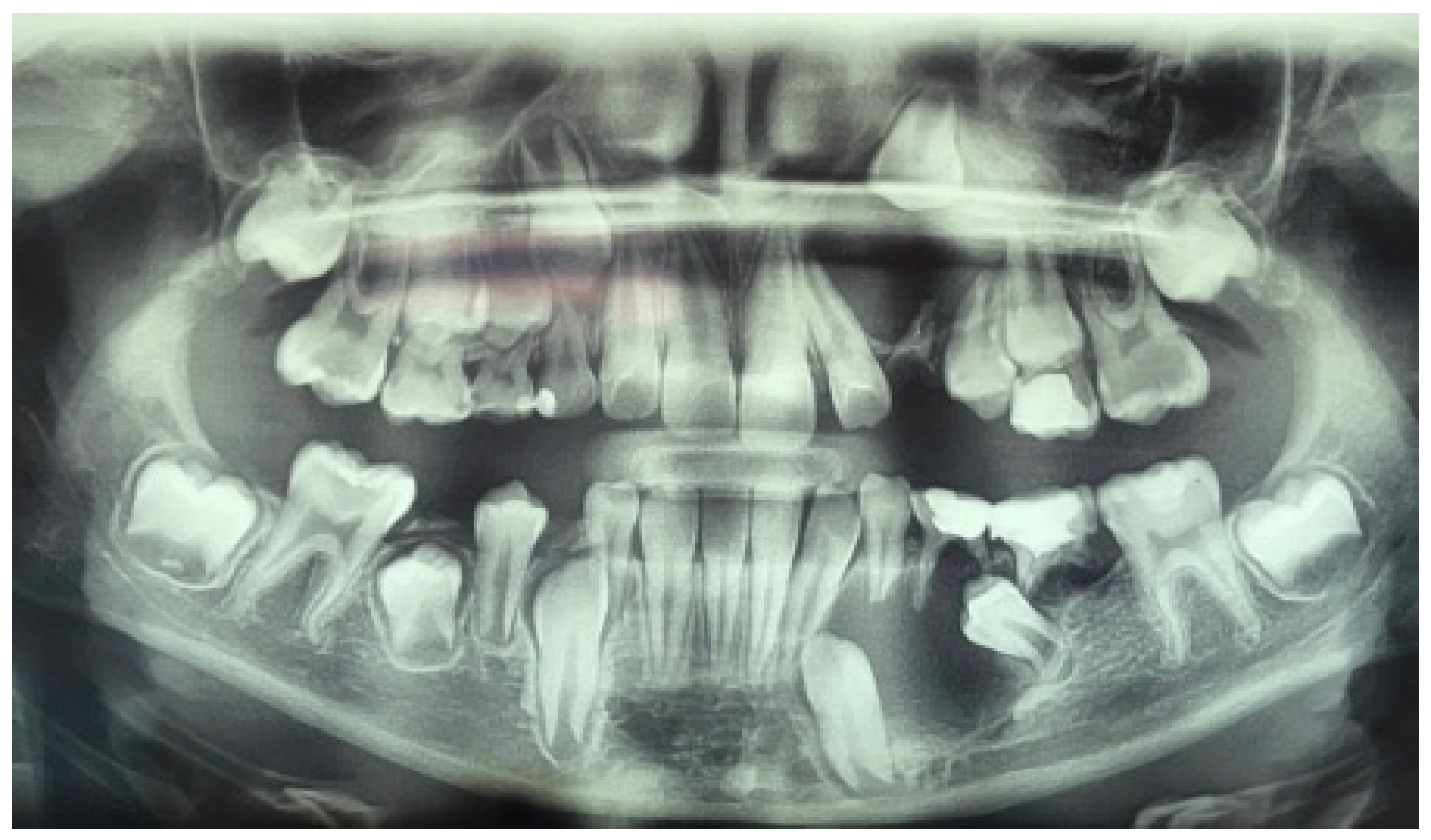 Synchronous Dentigerous Cysts Managed by Decompression in Non-Syndromic ...