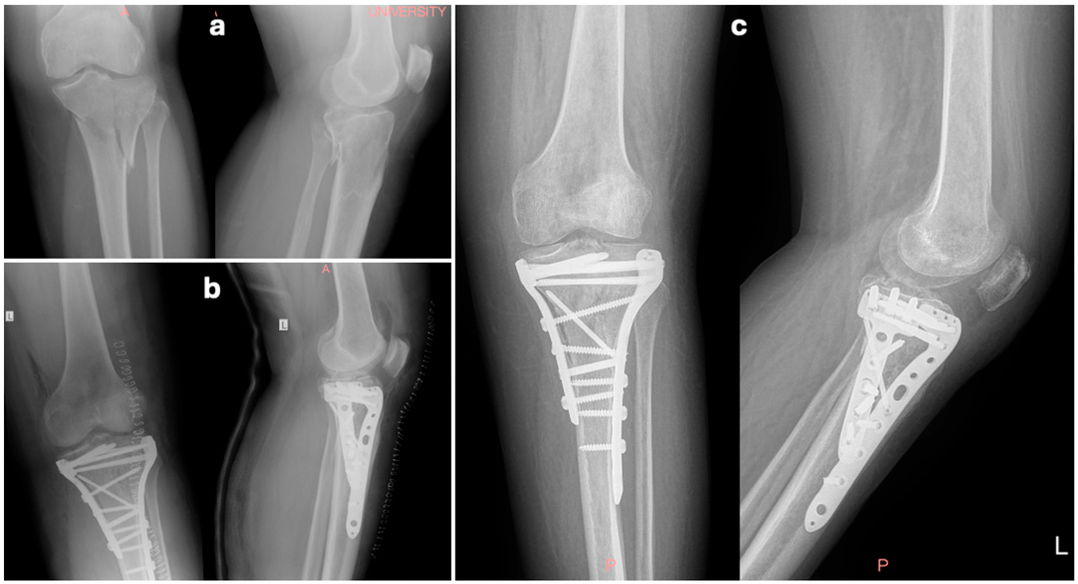 Comparative Outcomes of Single- Versus Dual-Incision Approaches for ...