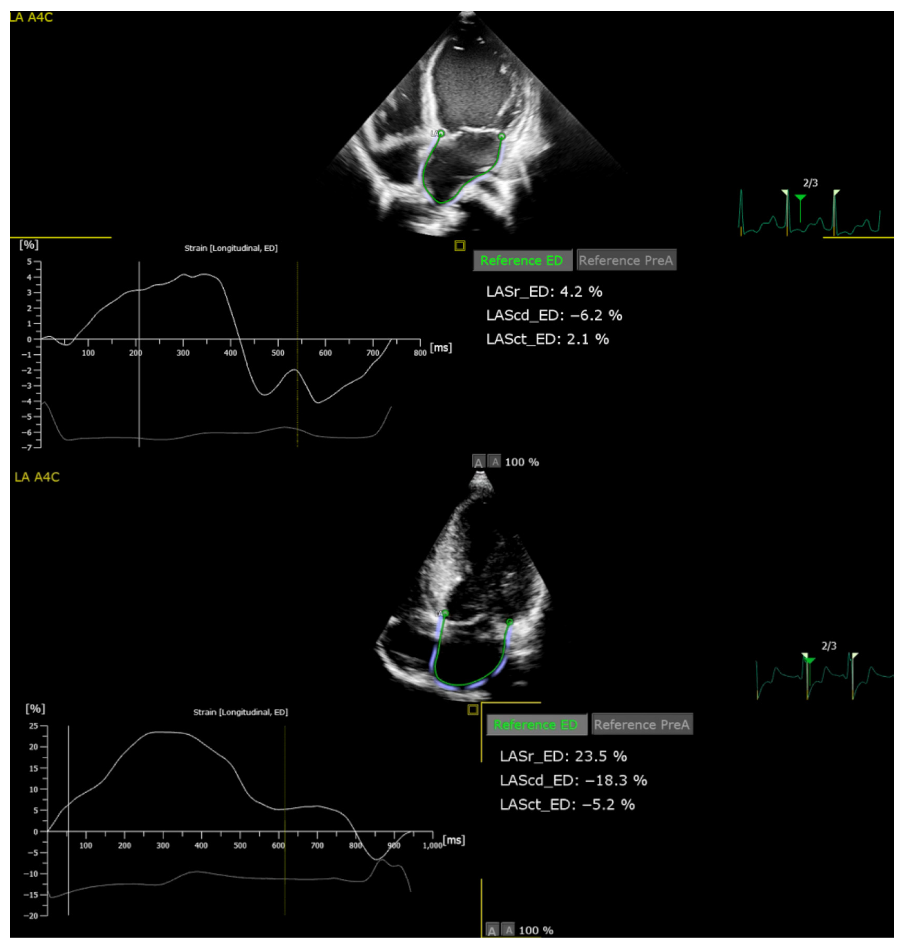 Left Atrial Deformation in Paediatric Dilated and Hypertrophic ...