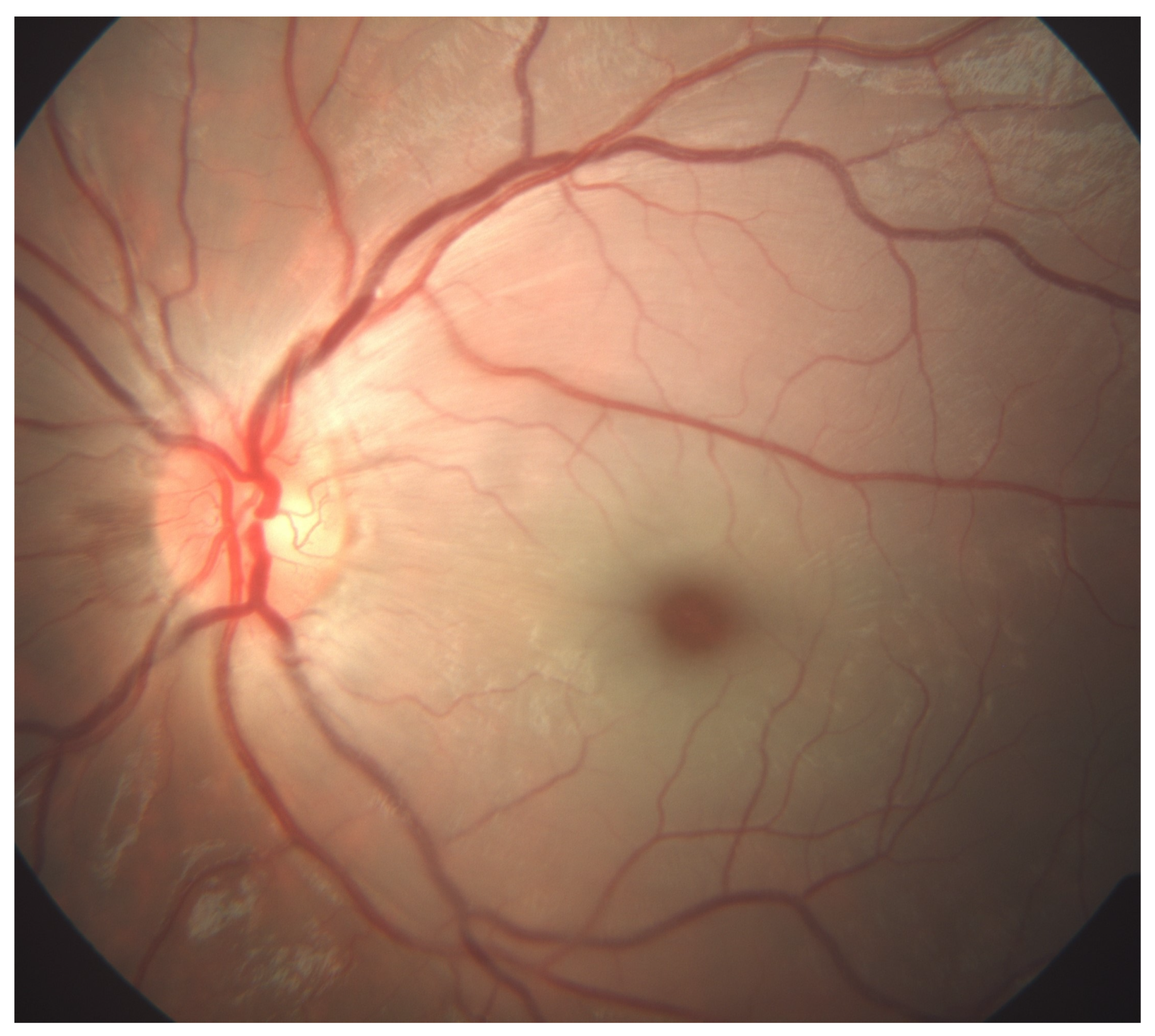 Central Retinal Artery Occlusion in a 6-Year-Old Child with an Acute ...