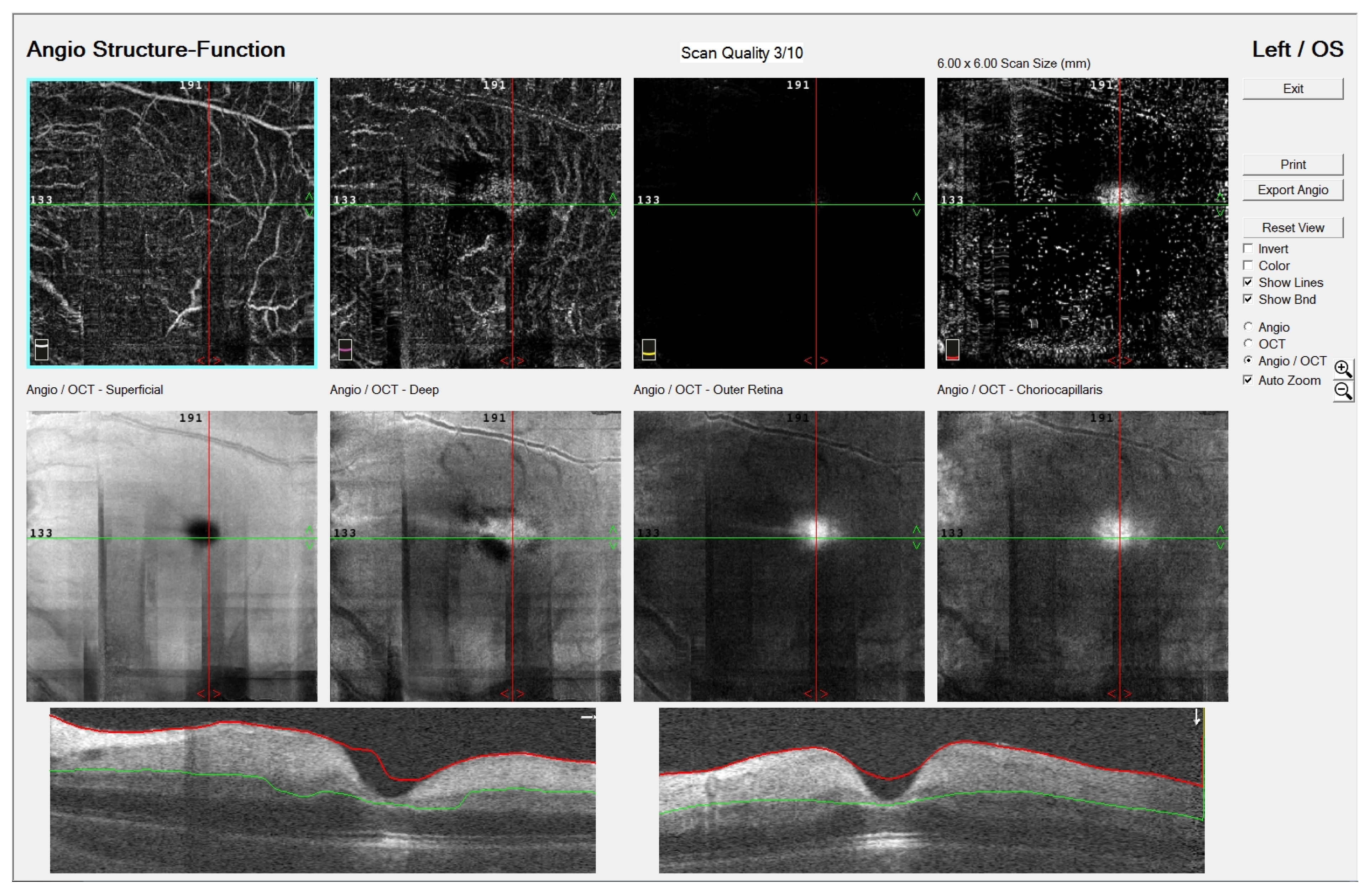 Central Retinal Artery Occlusion in a 6-Year-Old Child with an Acute ...