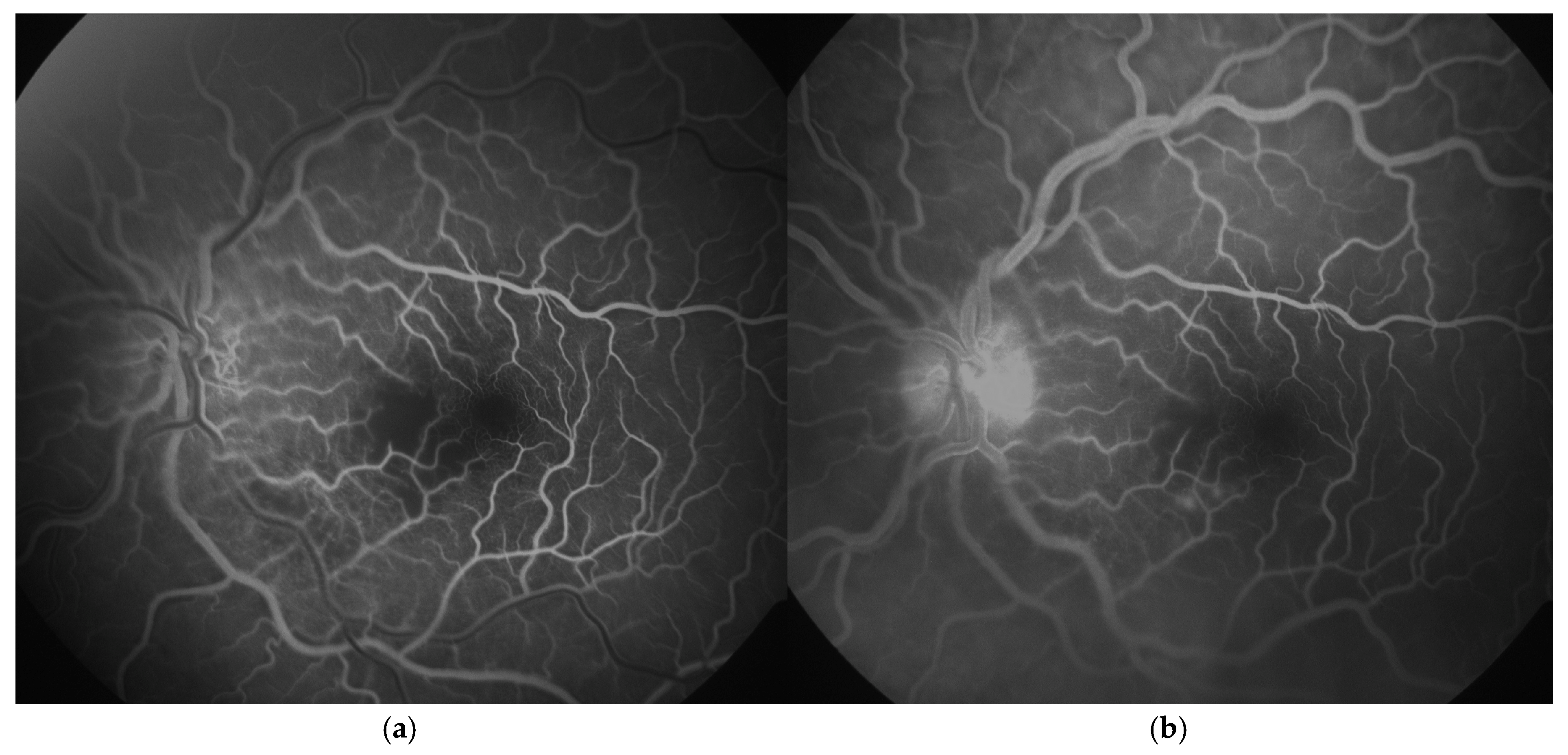 Central Retinal Artery Occlusion in a 6-Year-Old Child with an Acute ...