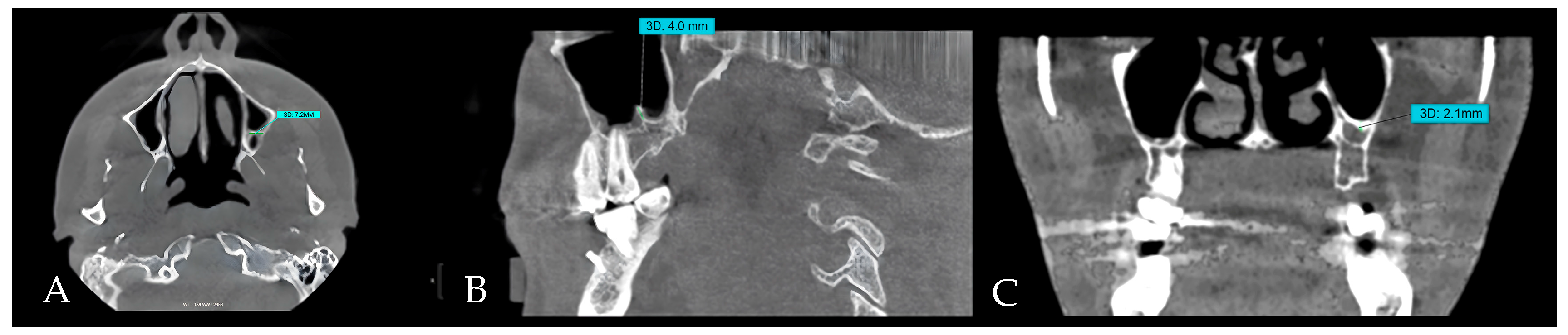 Assessment of the Sinus Septa Using CBCT: A Cross-Sectional Study in ...