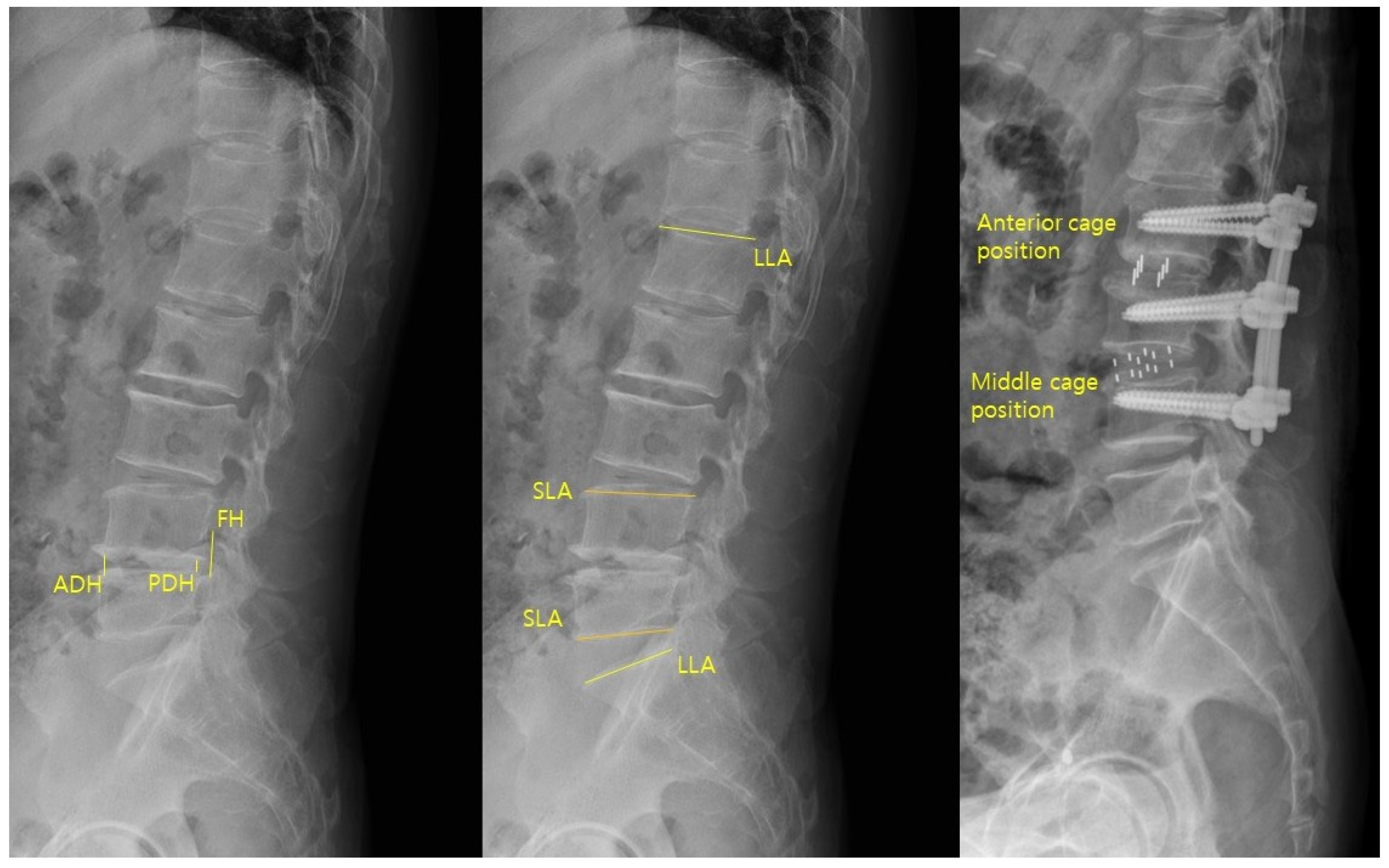 Predictors of Cage Subsidence After Oblique Lumbar Interbody Fusion