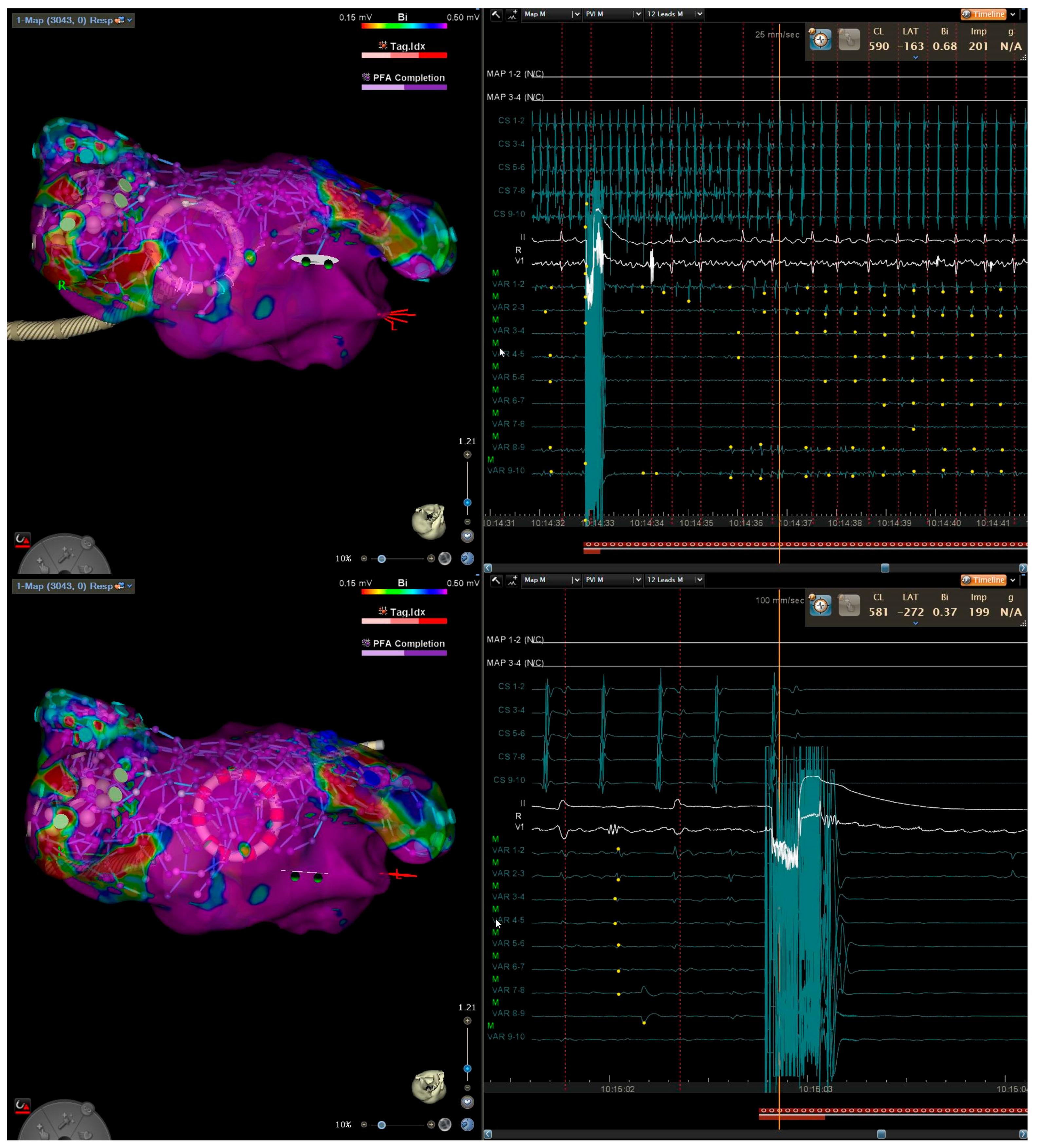 Single-Center Real World Experience with the VARIPULSE Platform for ...