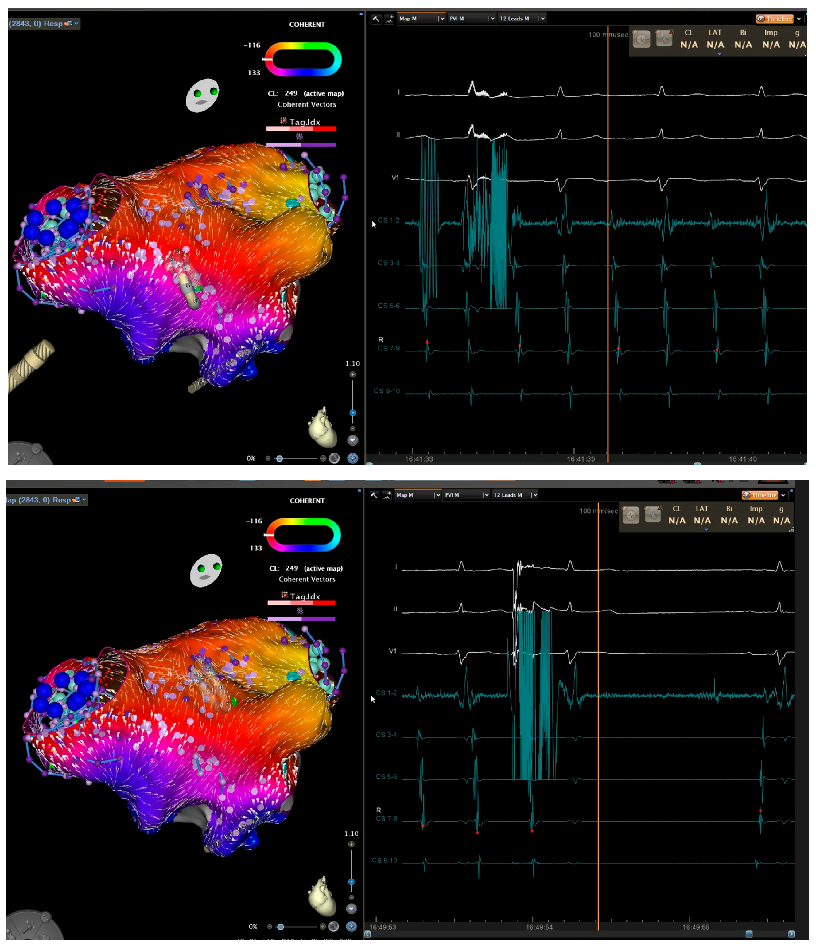 Single-Center Real World Experience with the VARIPULSE Platform for ...