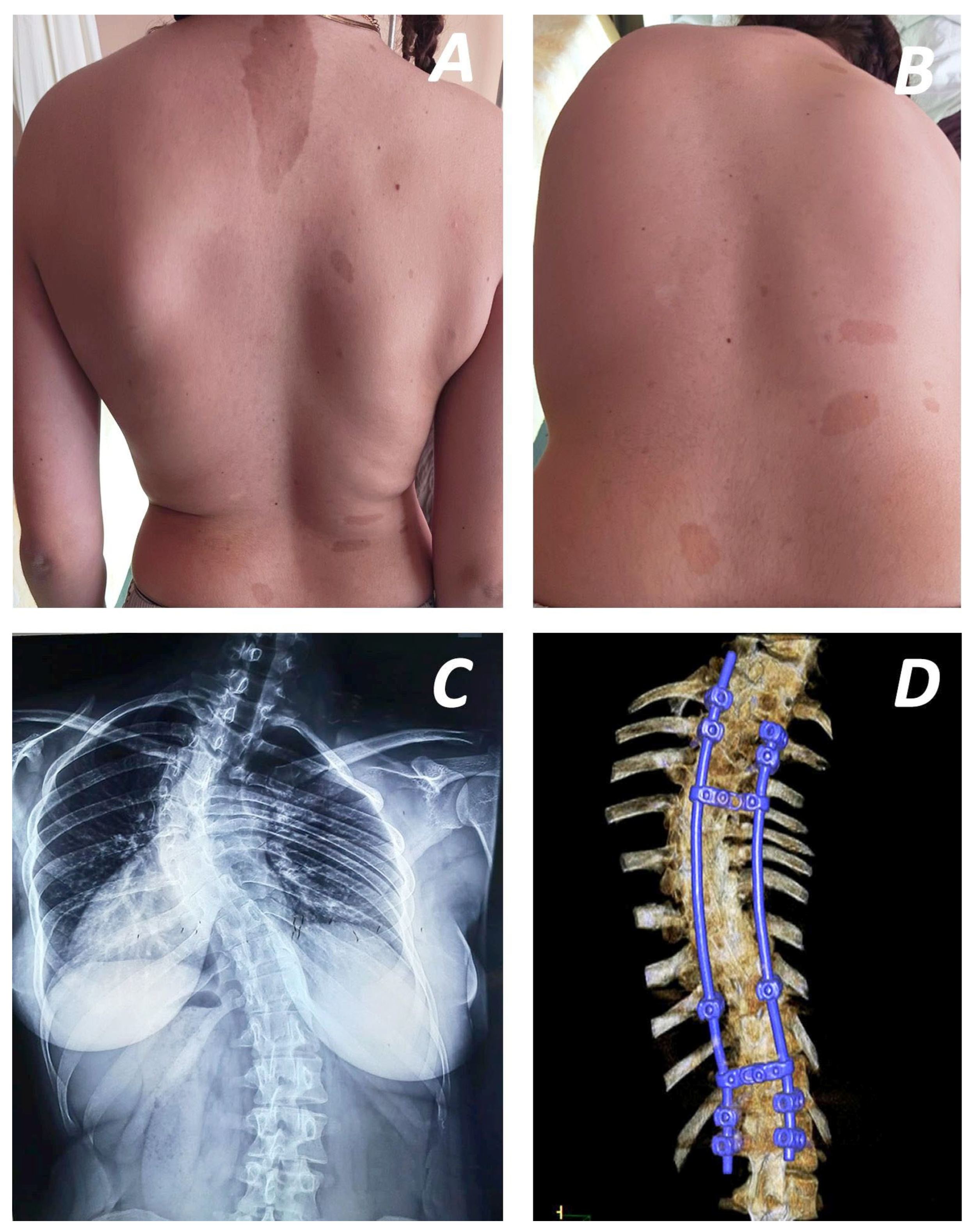 Tips and Pitfalls of Surgical Techniques for Scoliotic Deformities in ...