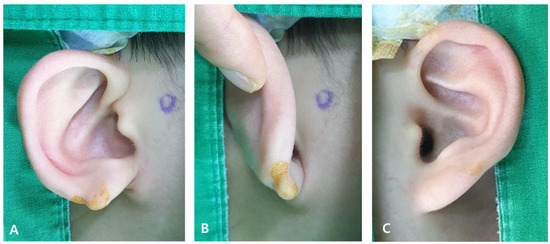 Congenital Cleft Earlobe: Classification and Surgical Techniques with a ...
