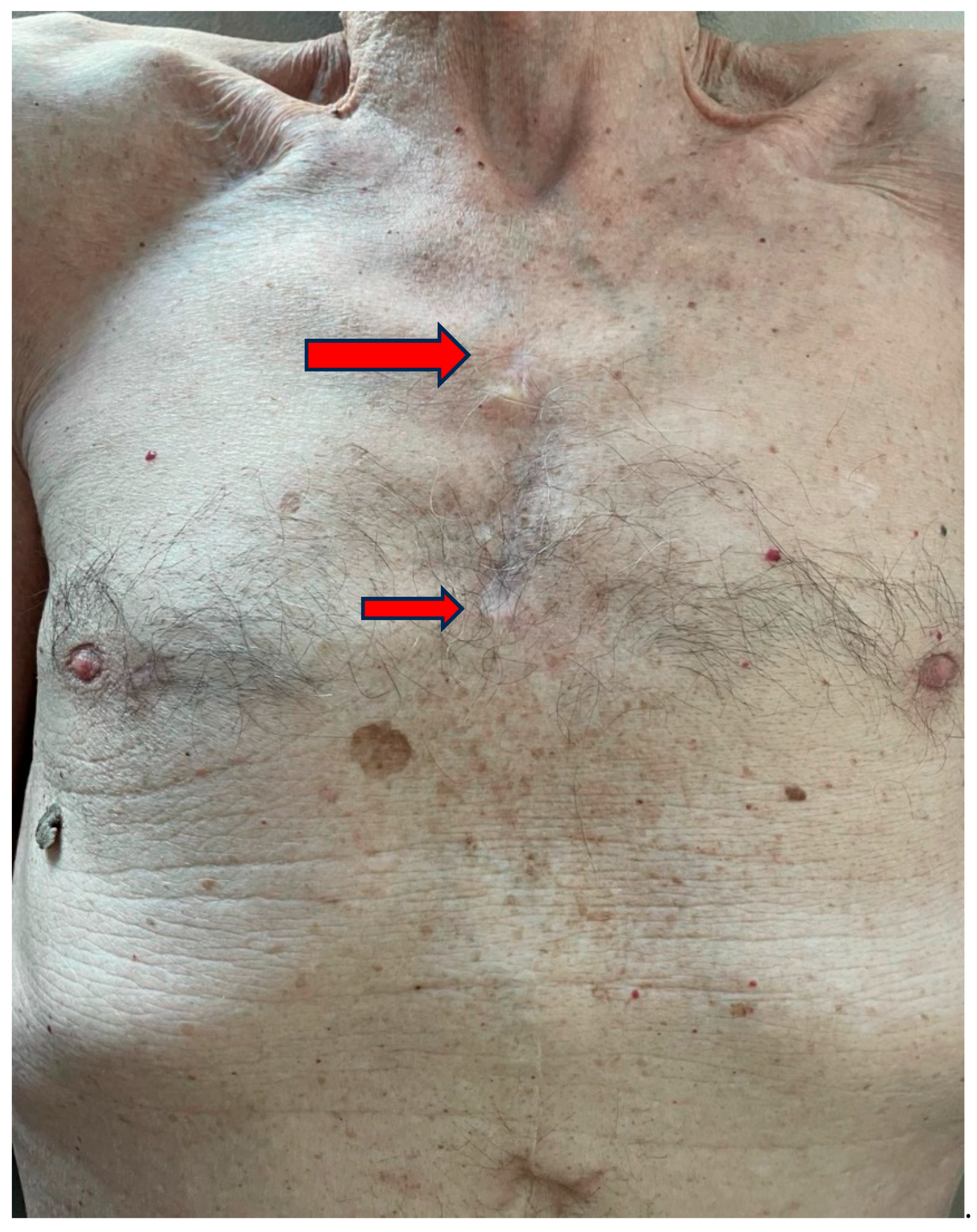 Minimally Invasive Cardiac Surgery: A State-of-the-Art Review