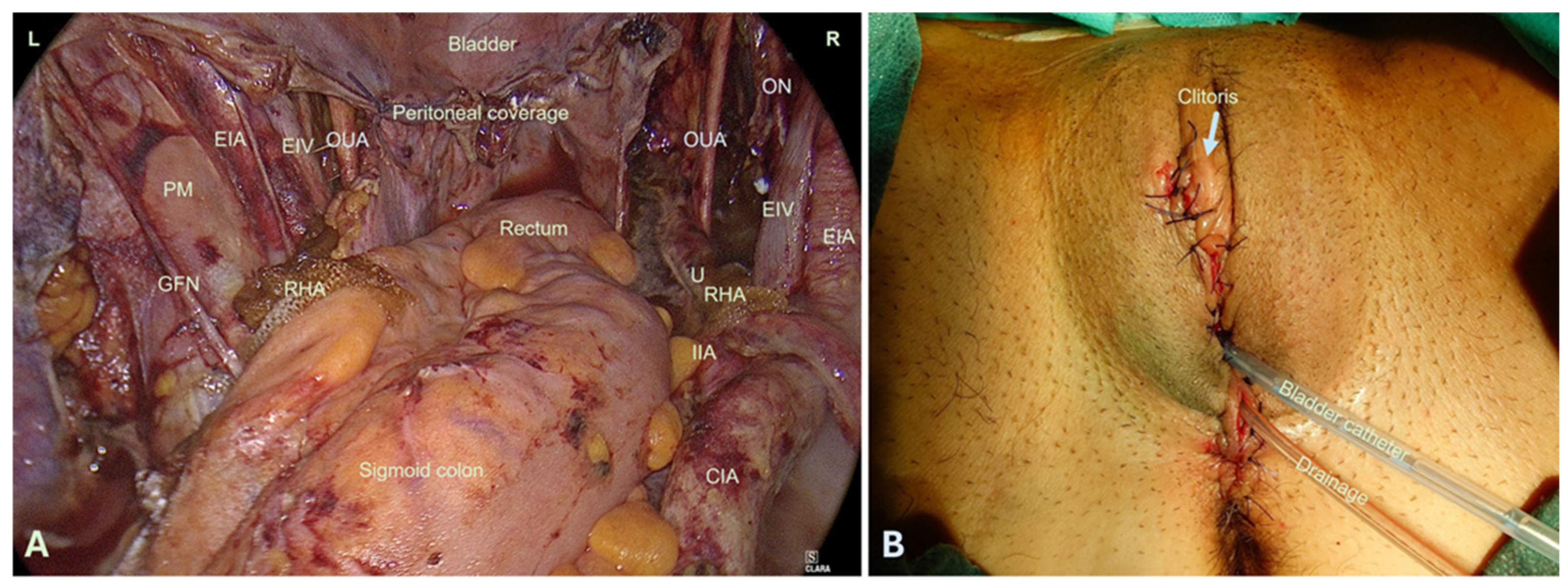 Feasibility of Laparoscopic Radical Colpectomy in Locally Advanced ...