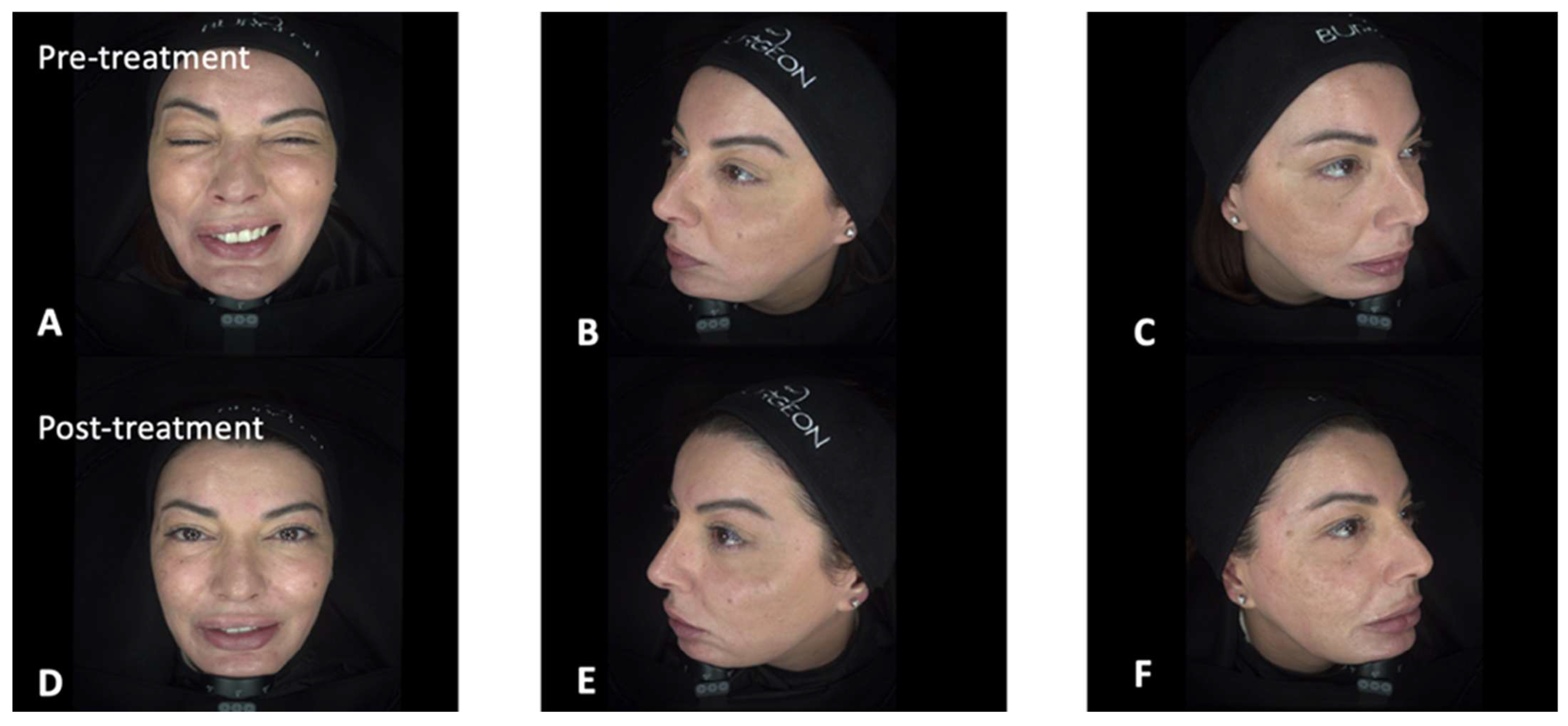 Aesthetic Rehabilitation of Patients with Central and Peripheral Facial ...