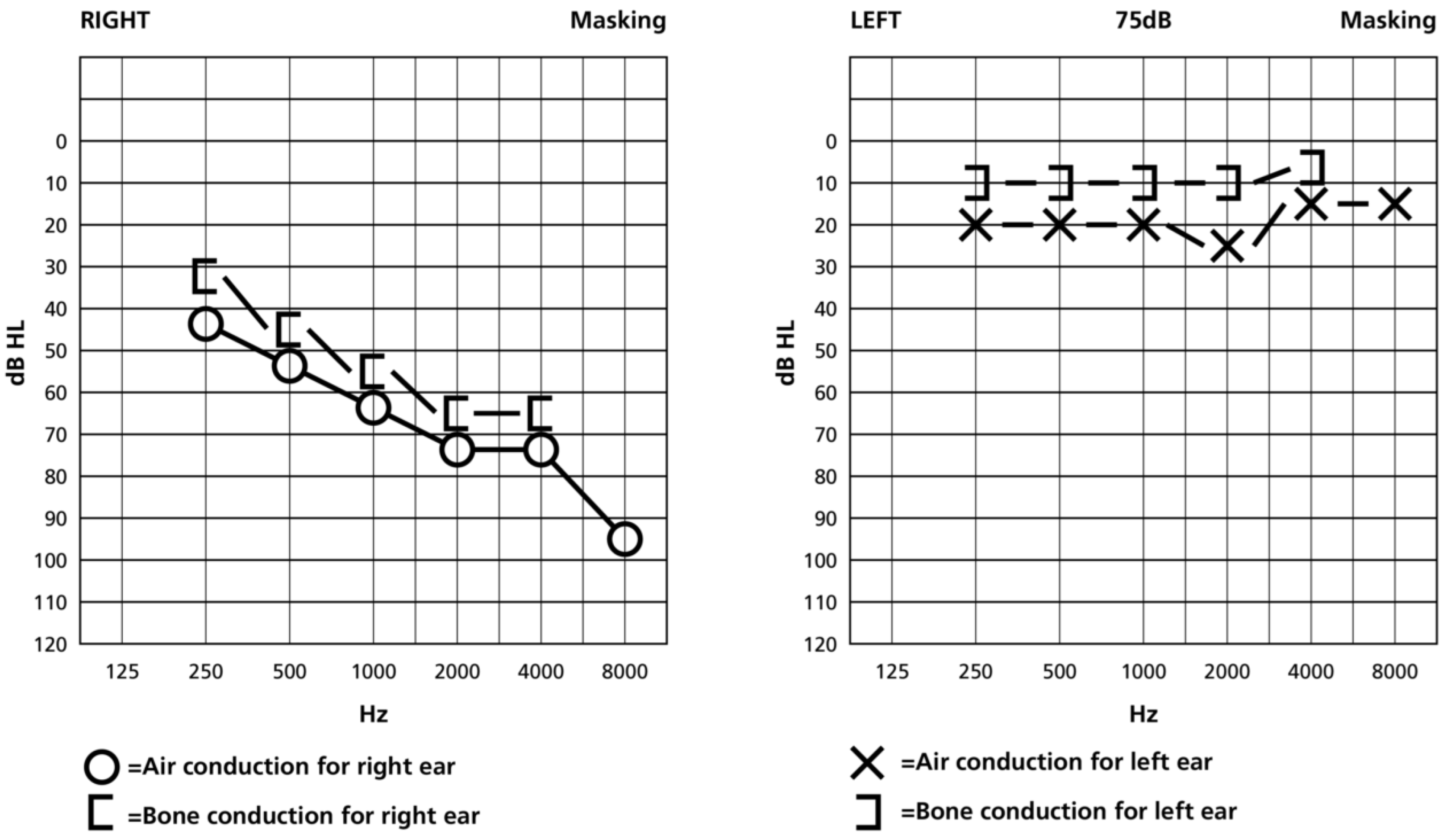 Hearing Loss in Neuromyelitis Optica Spectrum Disorder: Case Report and ...