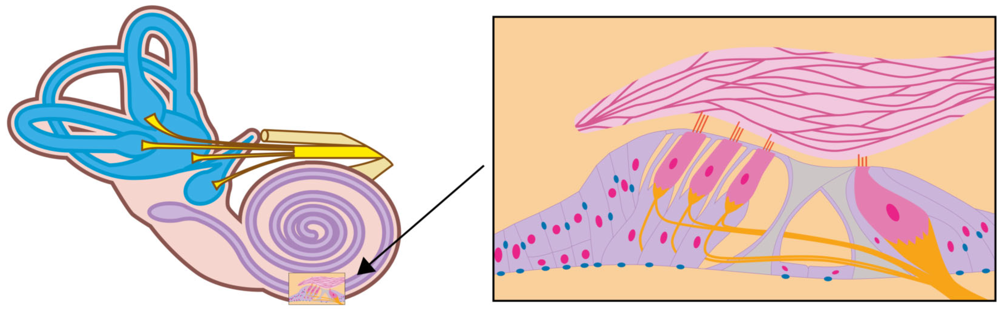 Hearing Loss in Neuromyelitis Optica Spectrum Disorder: Case Report and ...