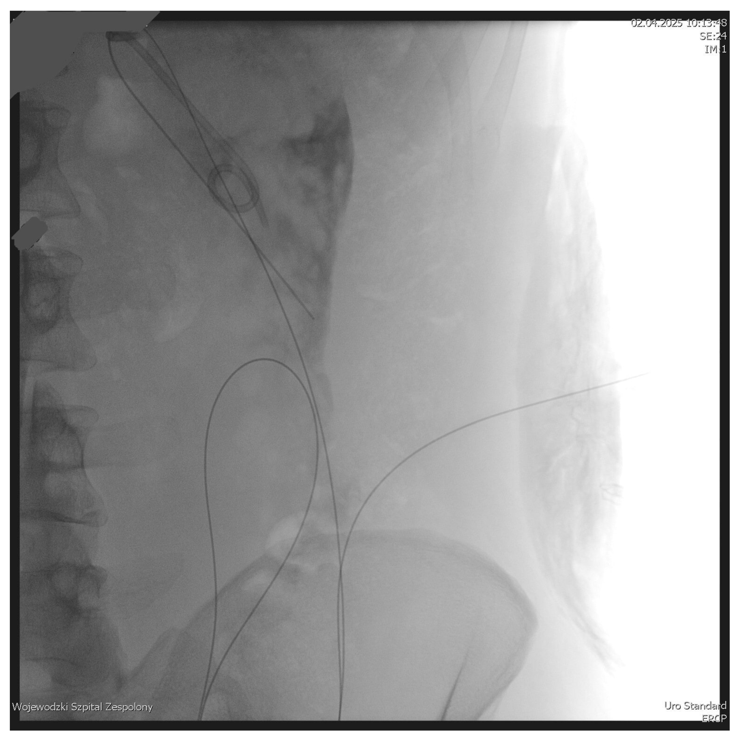 Percutaneous Endoscopic Necrosectomy of Walled-Off Pancreatic and ...