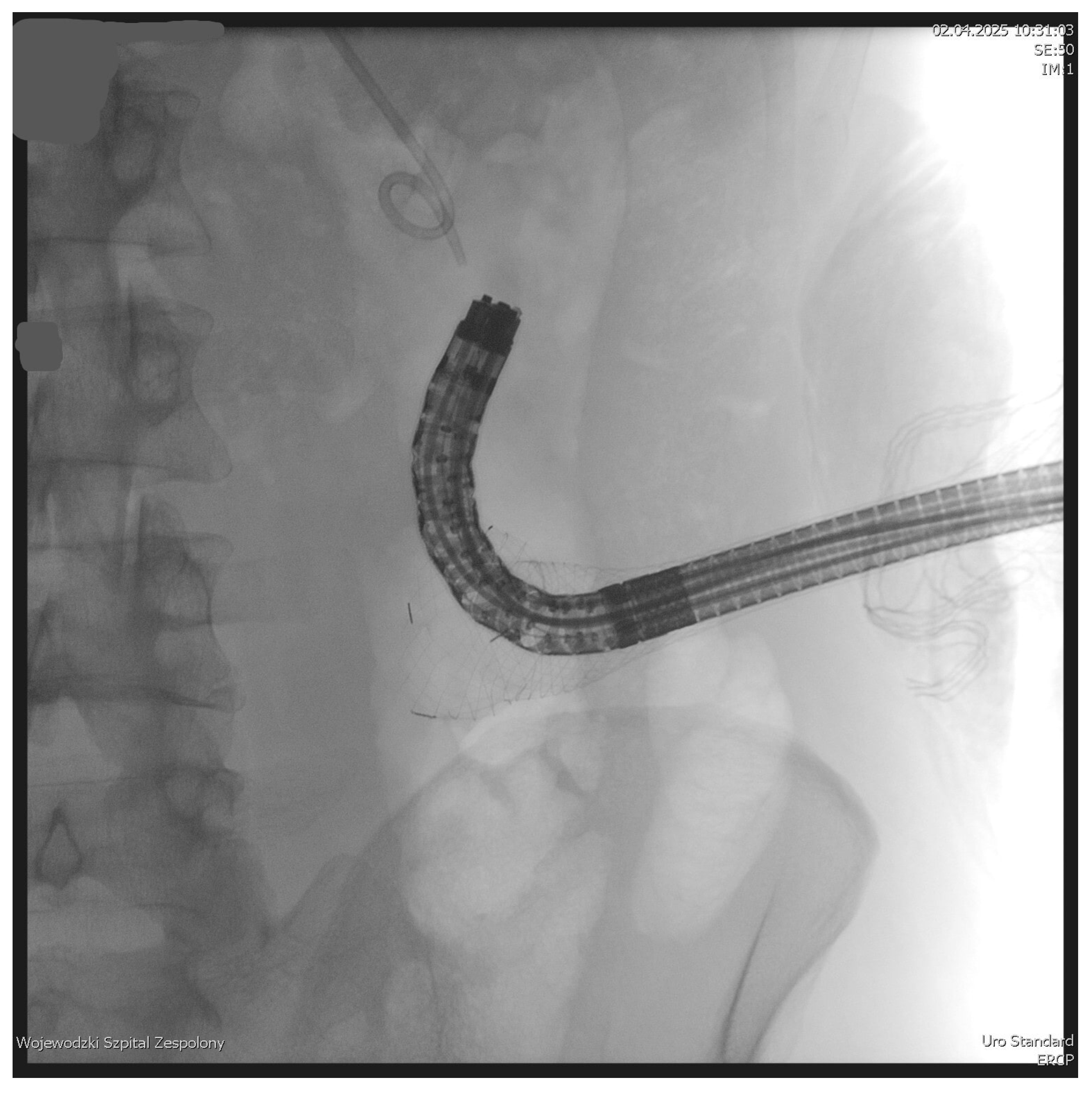 Percutaneous Endoscopic Necrosectomy of Walled-Off Pancreatic and ...