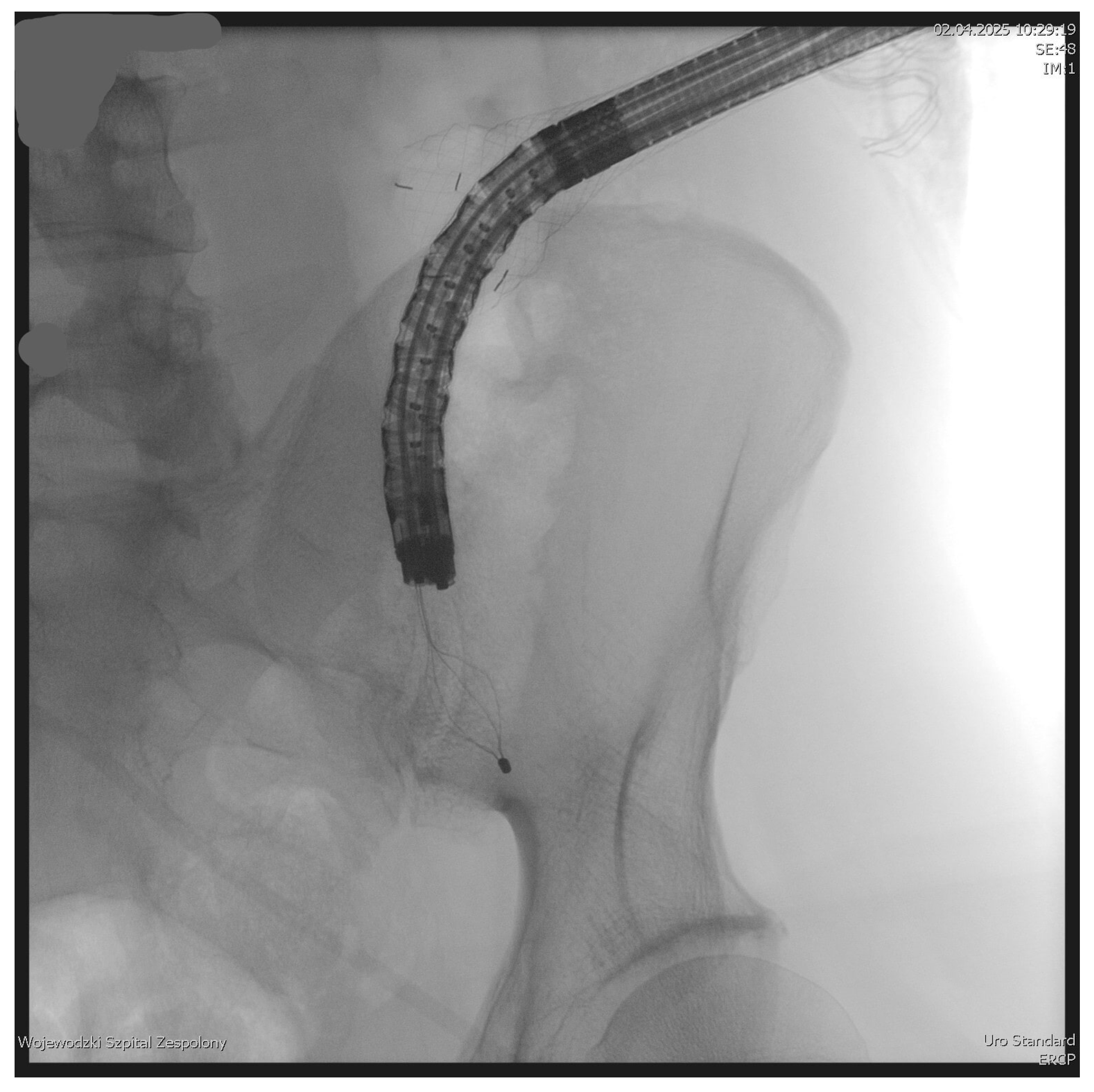 Percutaneous Endoscopic Necrosectomy of Walled-Off Pancreatic and ...
