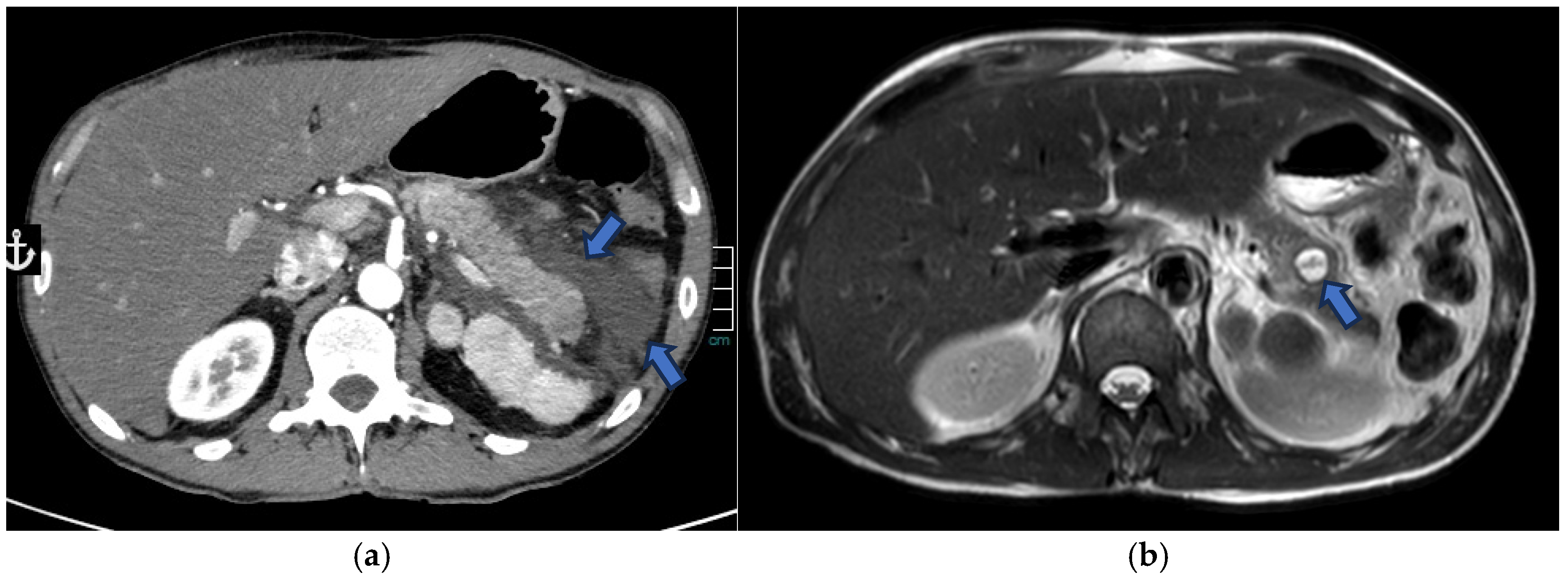 Pancreatic Cystic Lesions: From Basic Knowledge to Recent Guidelines