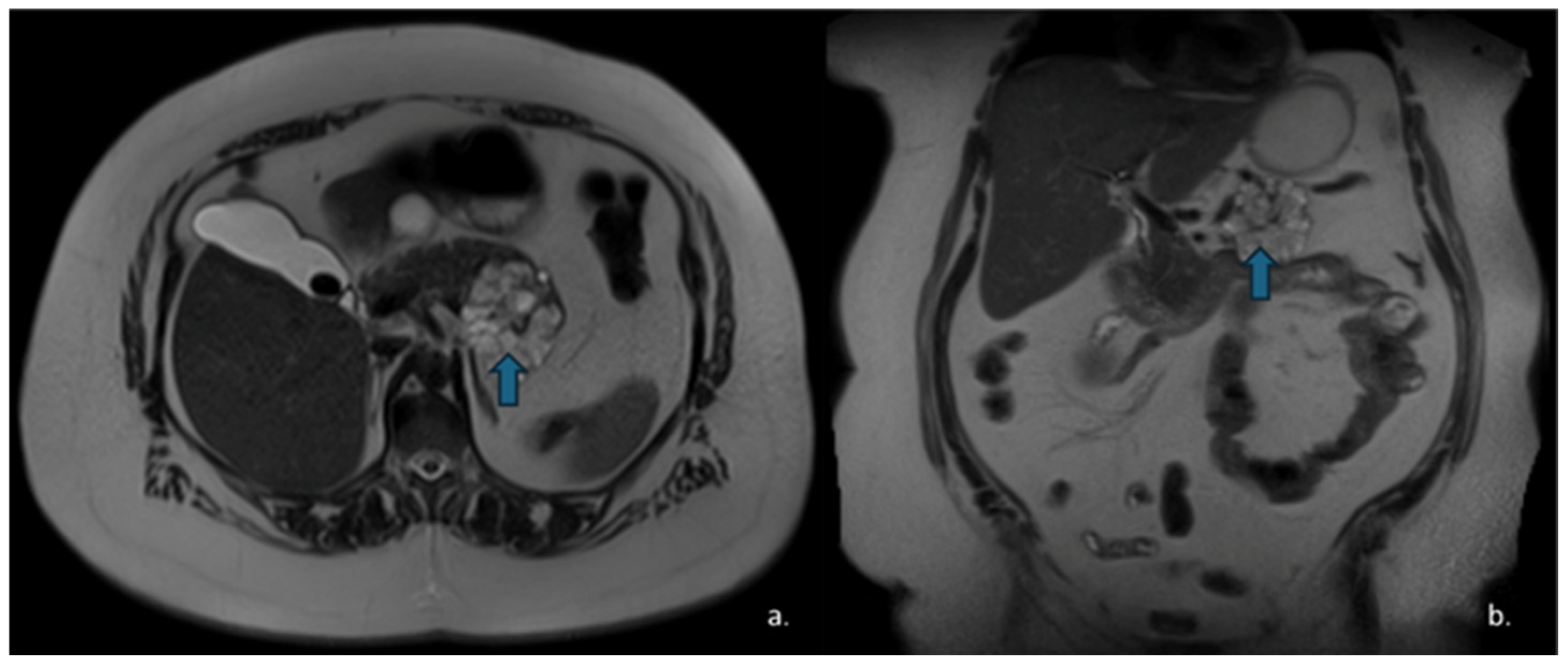 Pancreatic Cystic Lesions: From Basic Knowledge to Recent Guidelines
