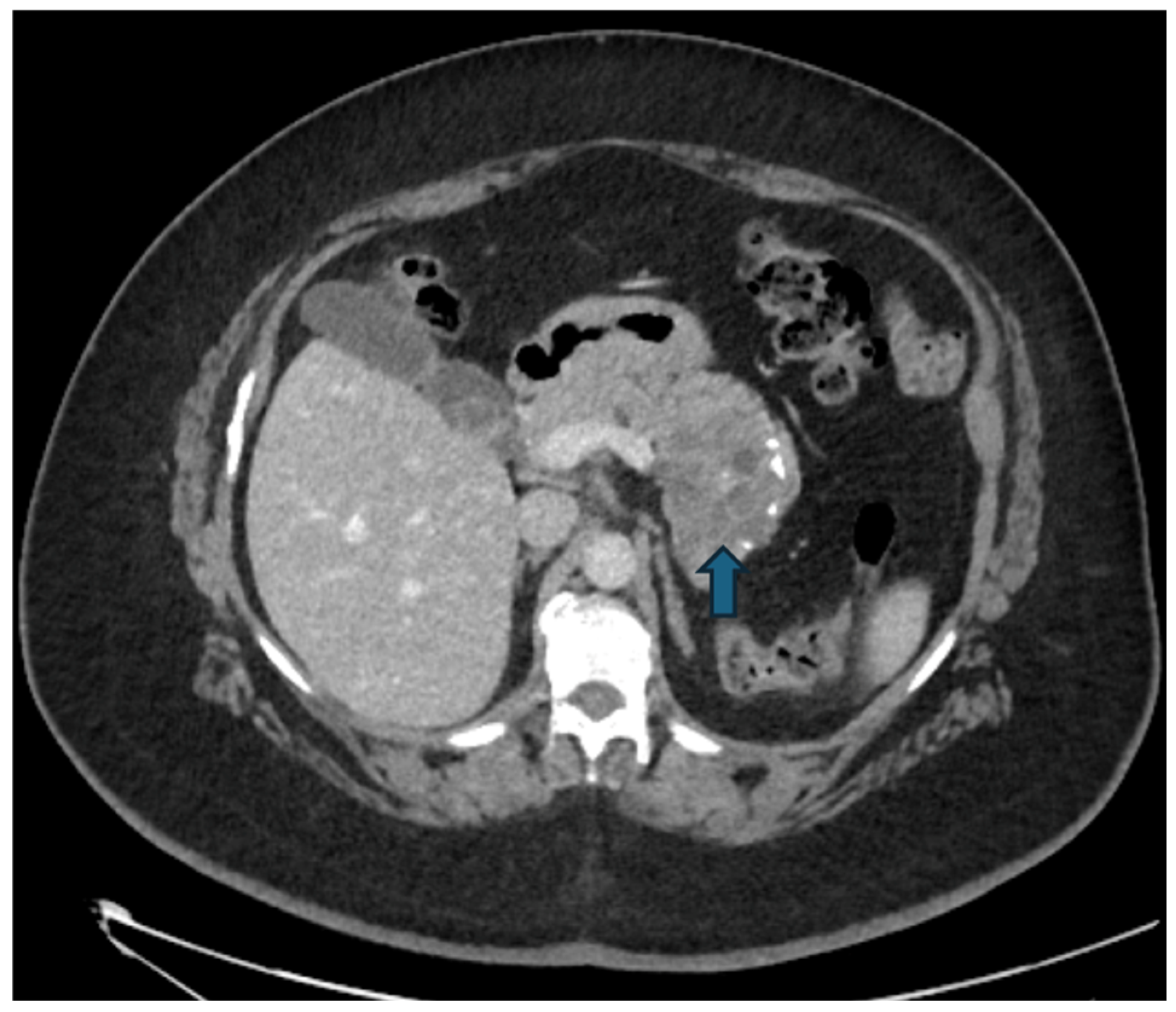 Pancreatic Cystic Lesions: From Basic Knowledge to Recent Guidelines