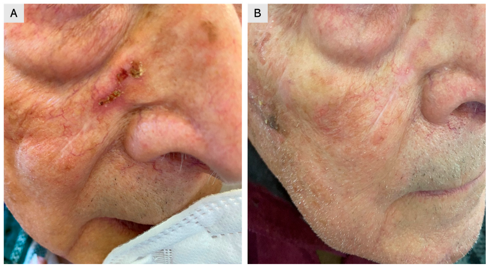 Efficacy of 4% 5-Fluorouracil Cream in the Treatment of Actinic ...
