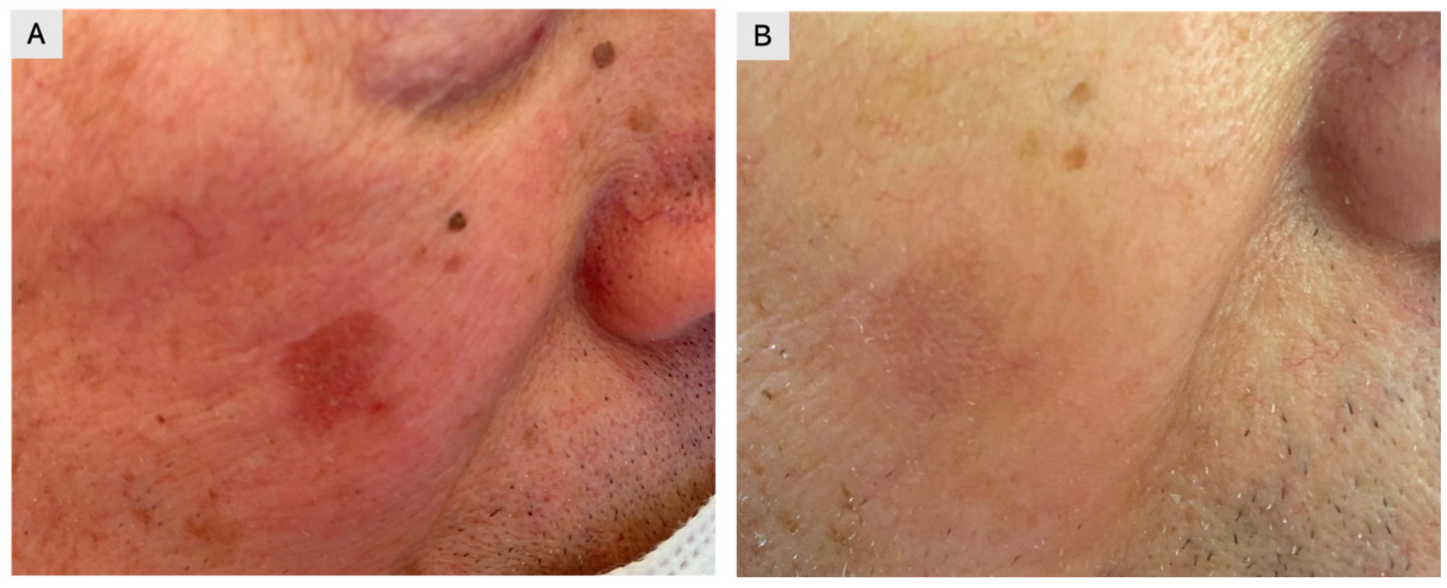 Efficacy of 4% 5-Fluorouracil Cream in the Treatment of Actinic ...