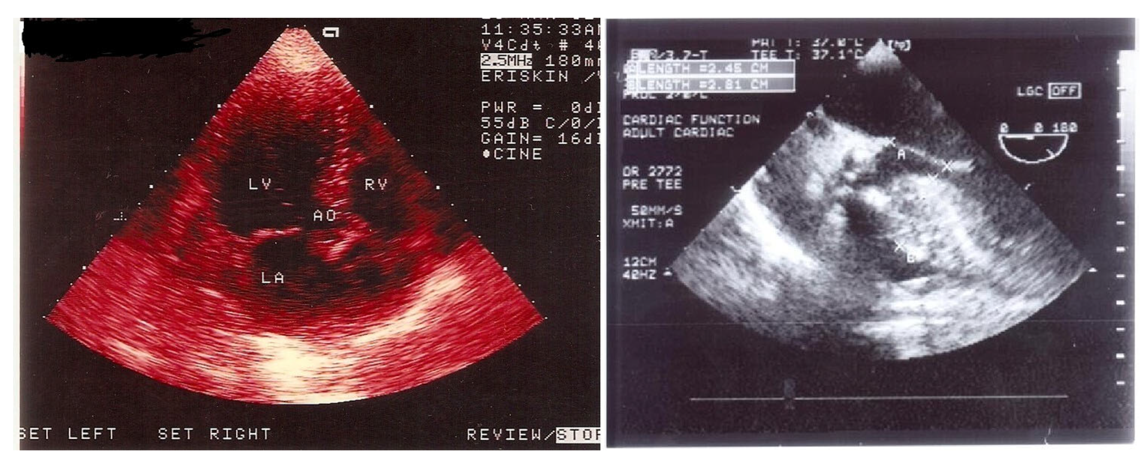 Aortic Stenosis as a Mechanical Stressor and Tissue Energetics ...