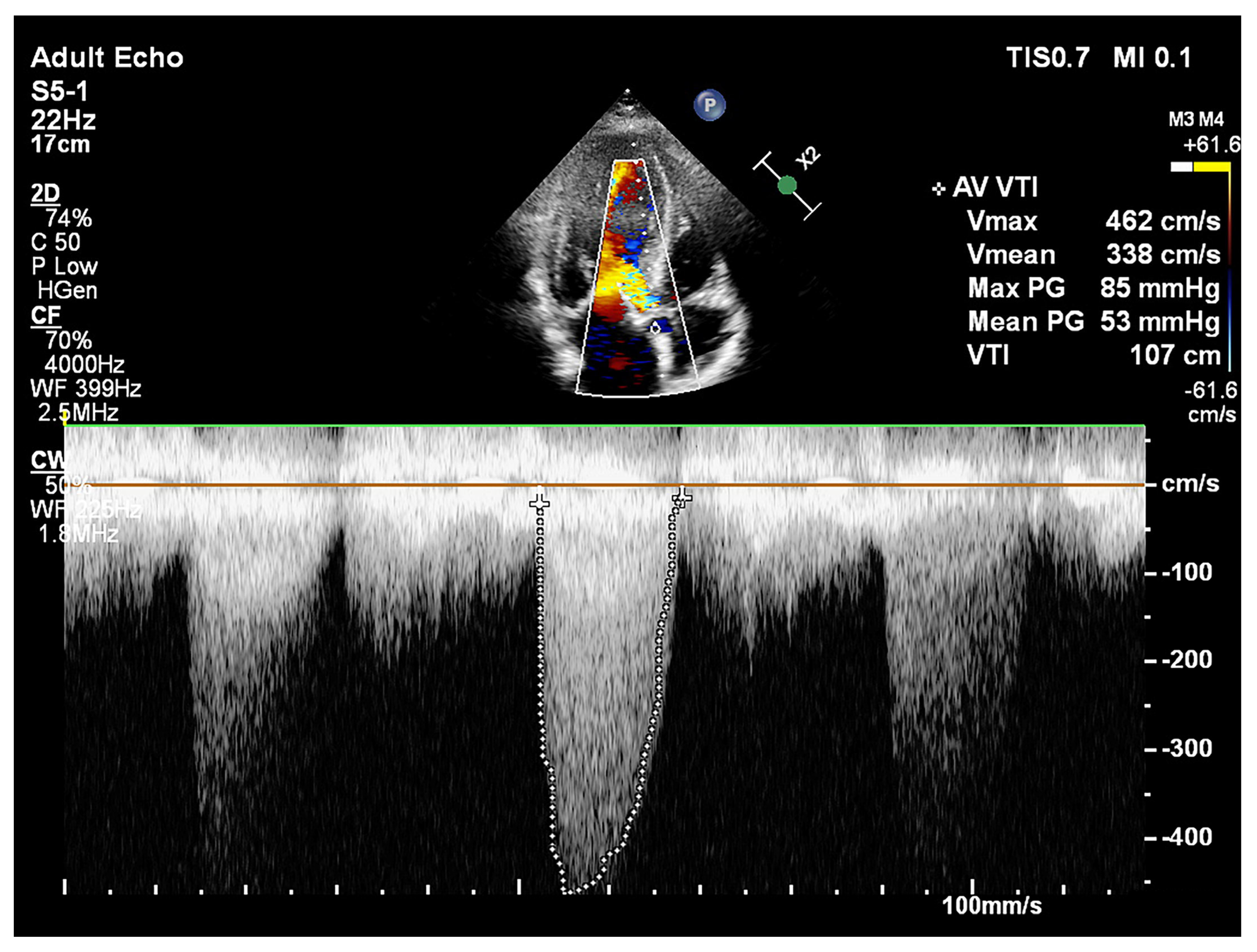 Aortic Stenosis as a Mechanical Stressor and Tissue Energetics ...