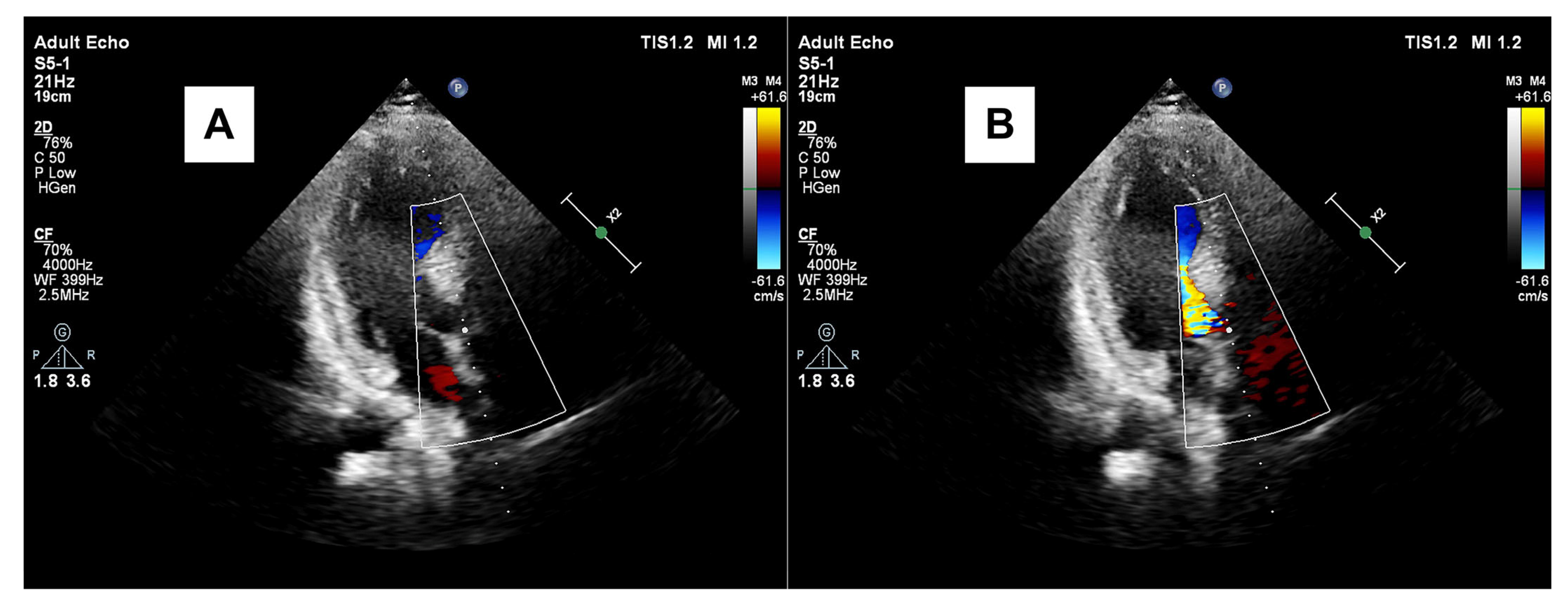Aortic Stenosis as a Mechanical Stressor and Tissue Energetics ...