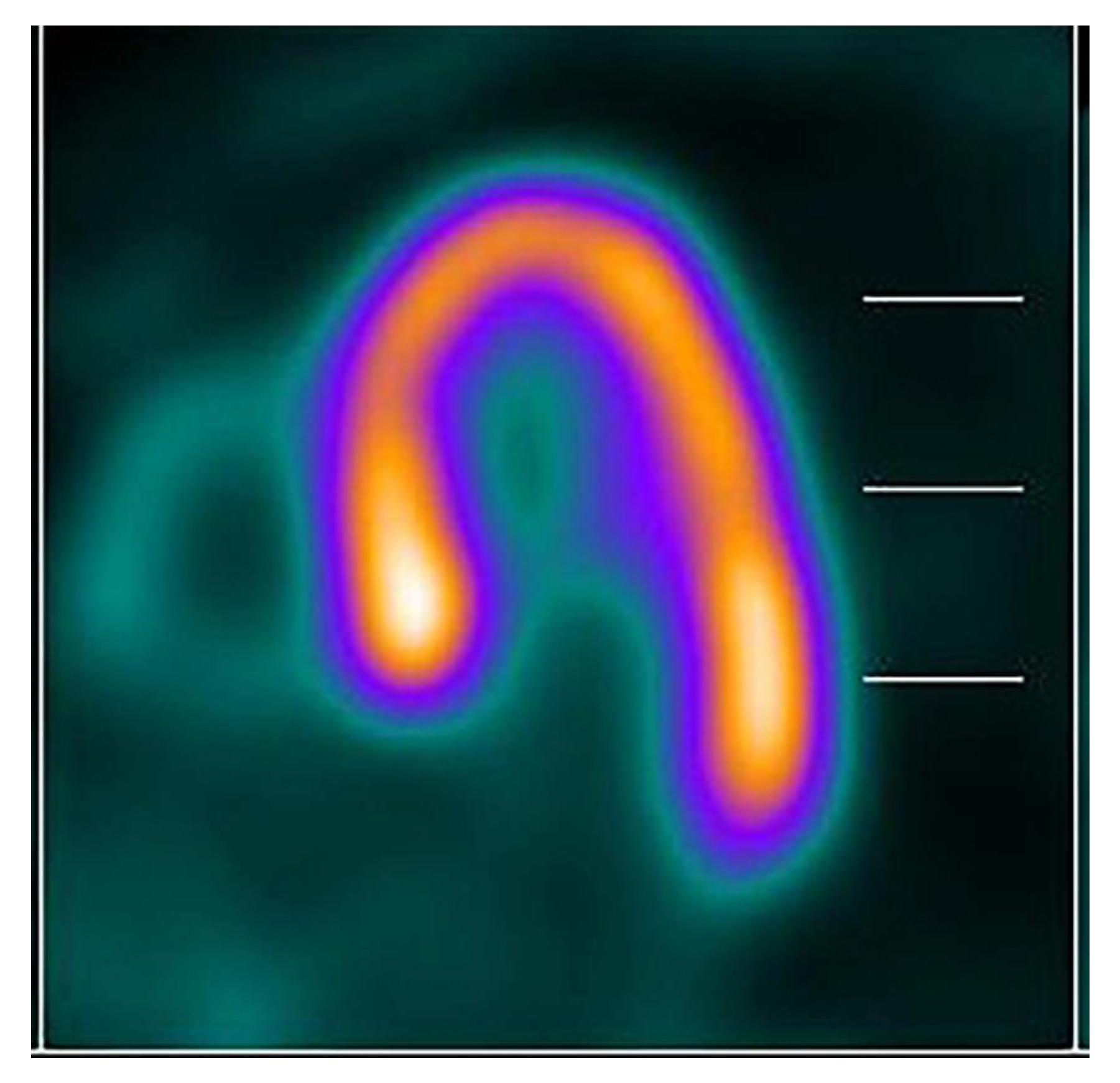 Aortic Stenosis as a Mechanical Stressor and Tissue Energetics ...