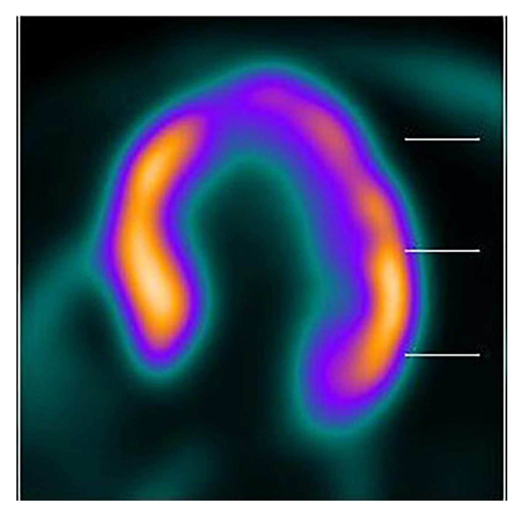 Aortic Stenosis as a Mechanical Stressor and Tissue Energetics ...