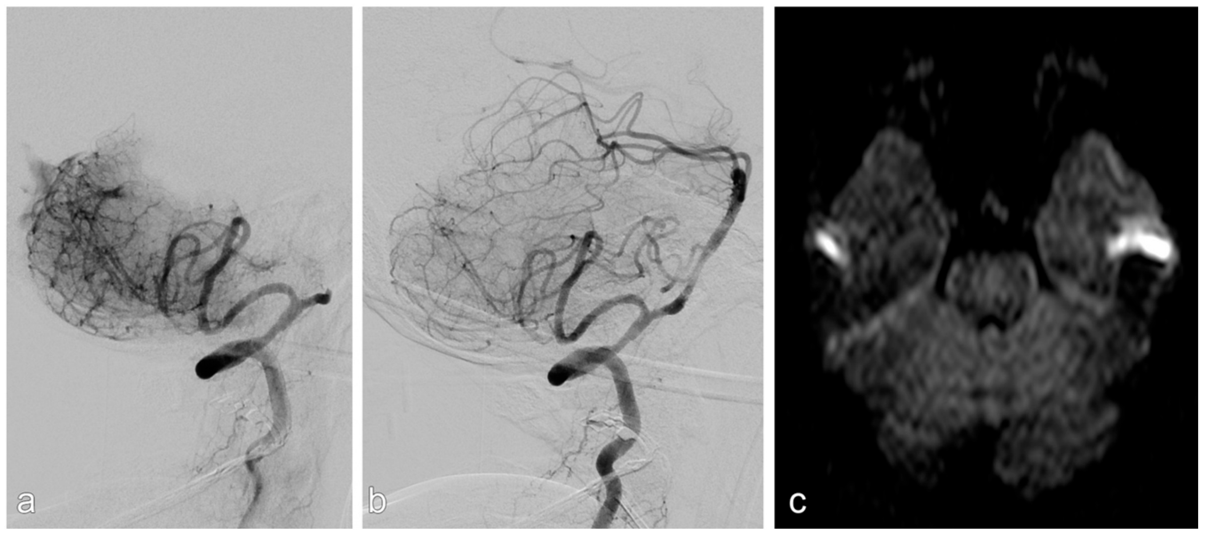 Percutaneous Transluminal Angioplasty and Stenting for Symptomatic ...