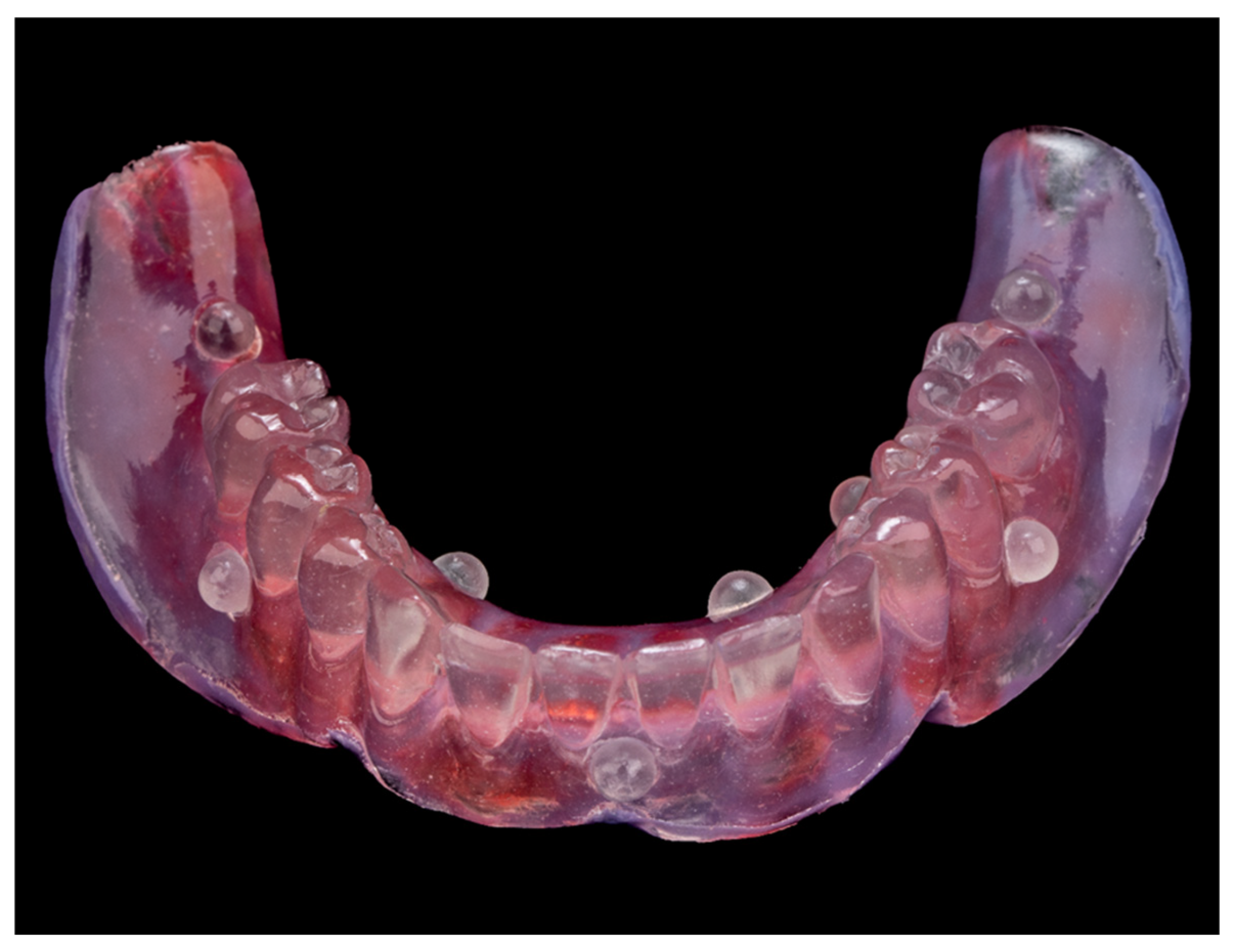 Accuracy of Fully Guided Implant Placement Using Bone-Supported ...