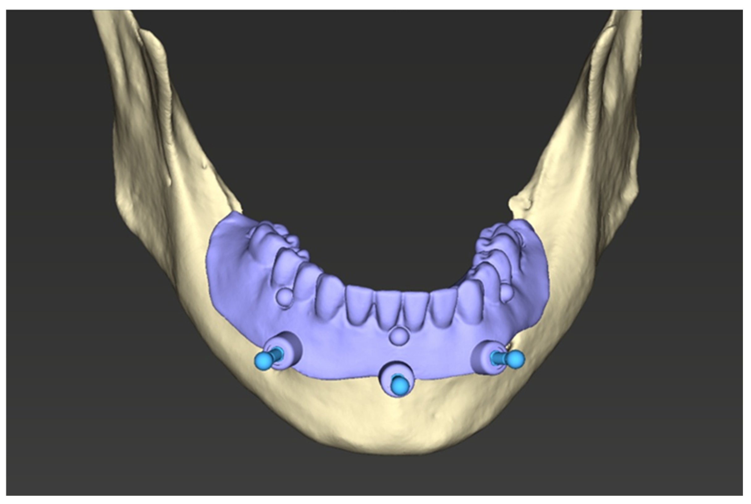 Accuracy of Fully Guided Implant Placement Using Bone-Supported Stackable Surgical Guides in ...