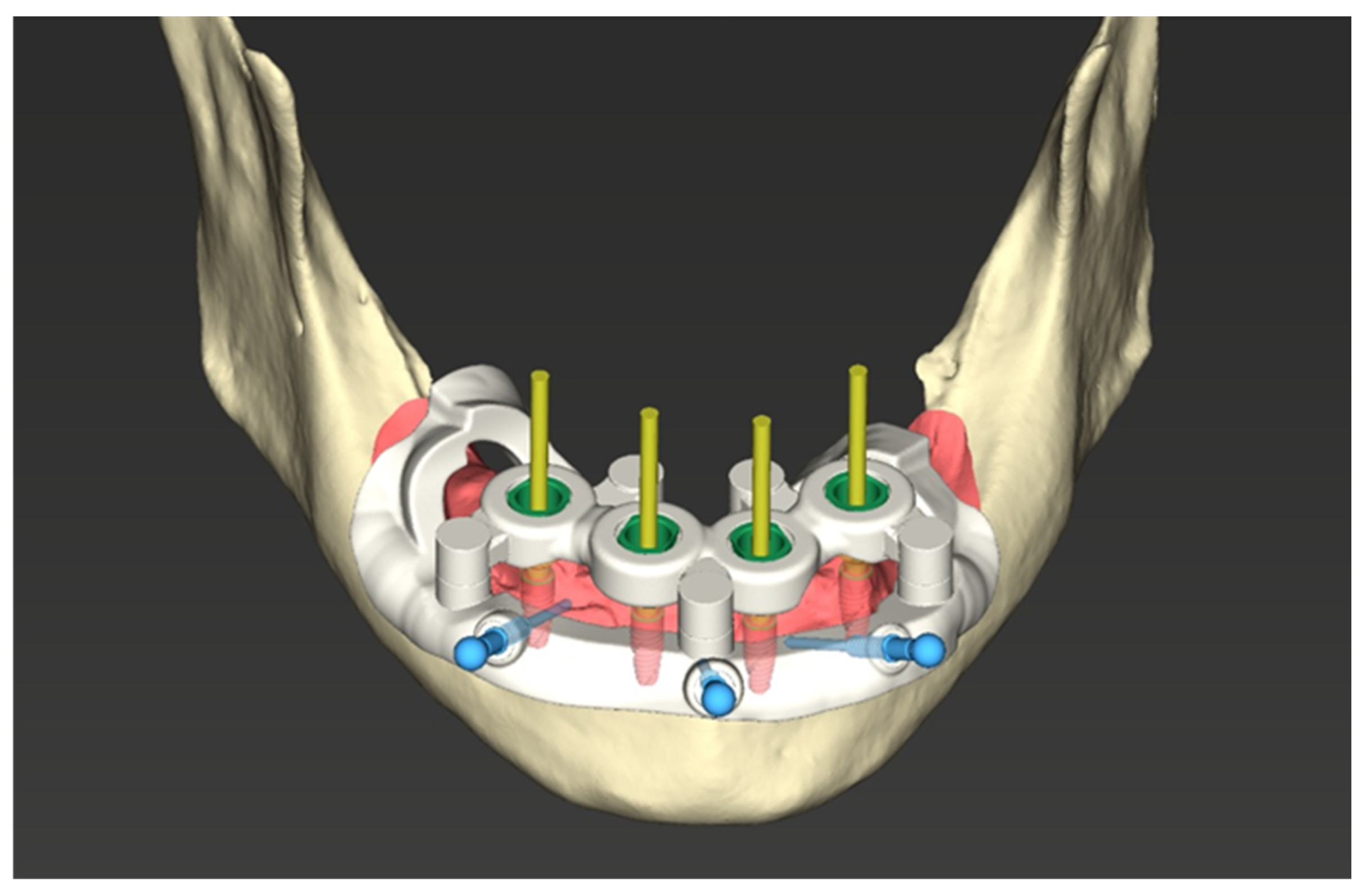 Accuracy of Fully Guided Implant Placement Using Bone-Supported ...