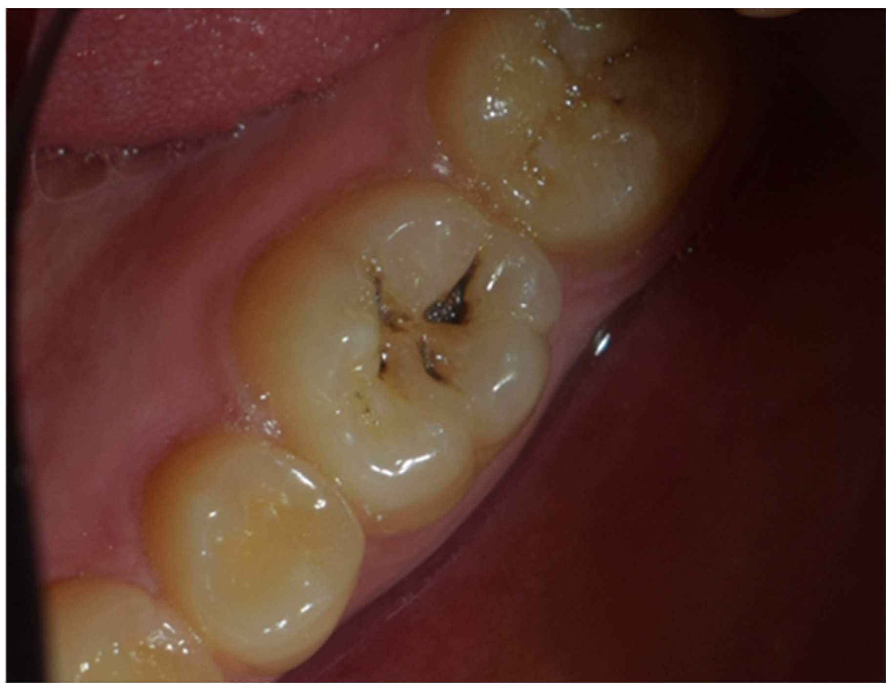 Direct and Semi-Direct Composite Techniques in Posterior Teeth: A Two ...