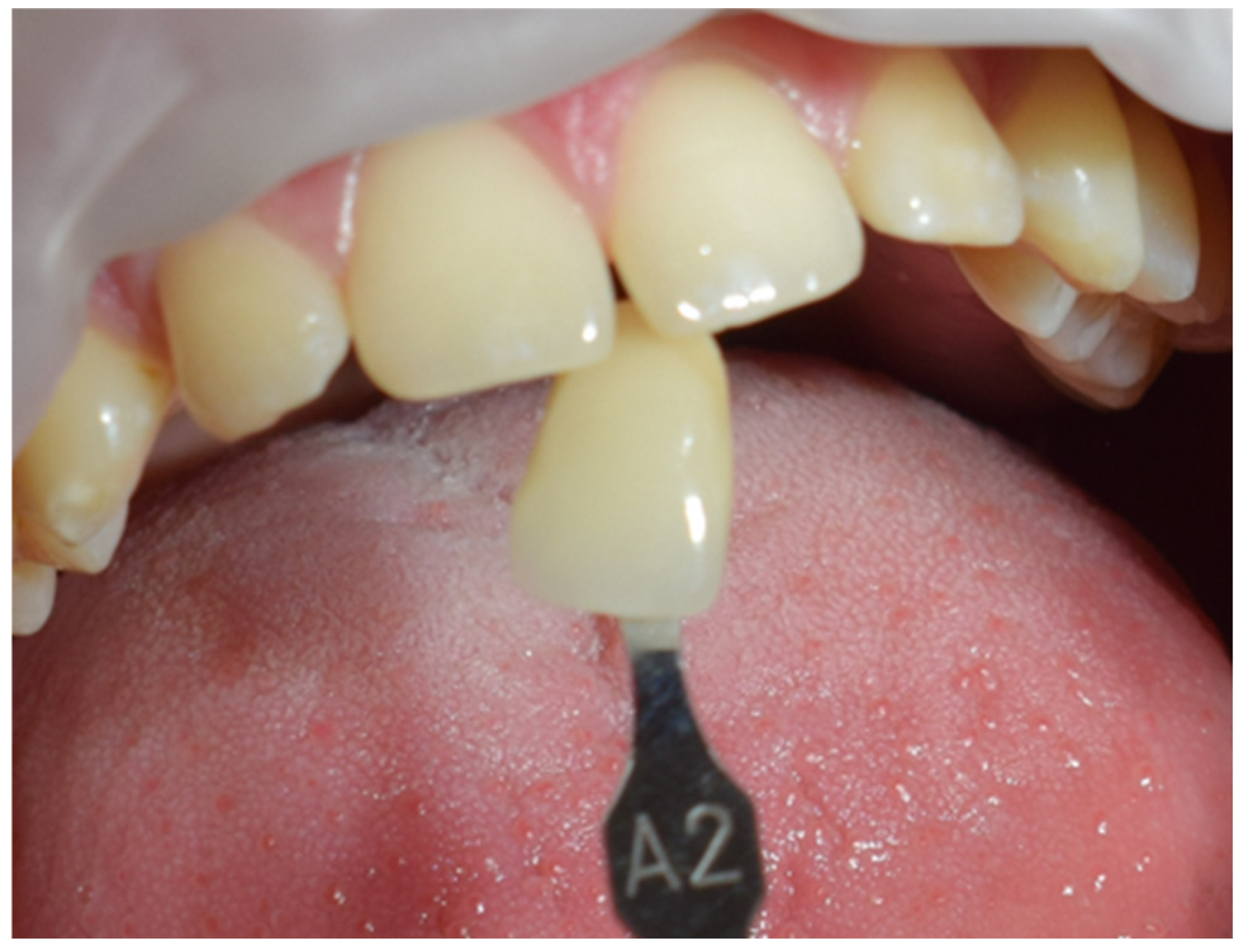 Direct and Semi-Direct Composite Techniques in Posterior Teeth: A Two ...
