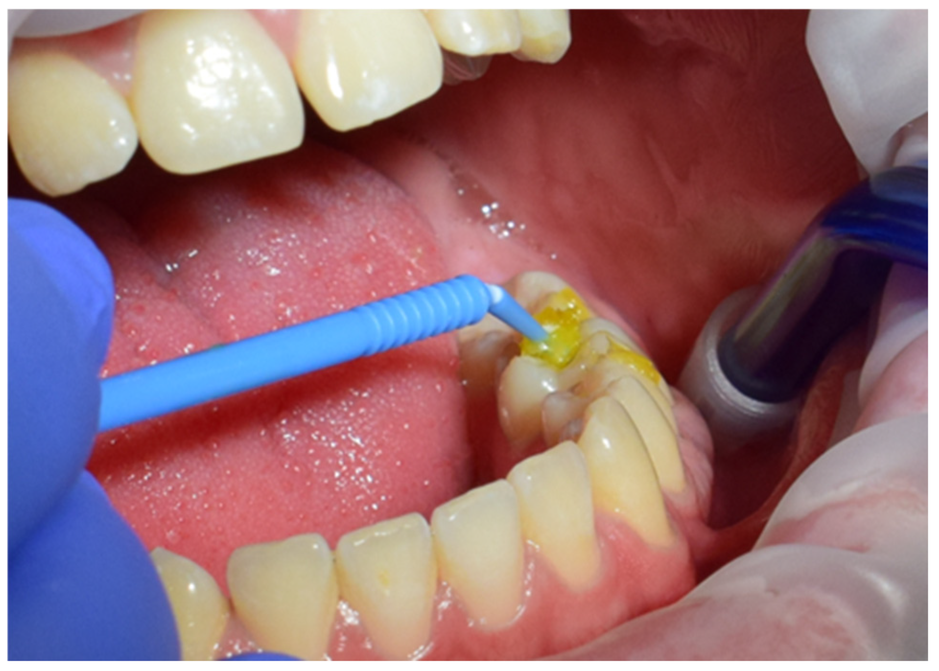 Direct and Semi-Direct Composite Techniques in Posterior Teeth: A Two ...