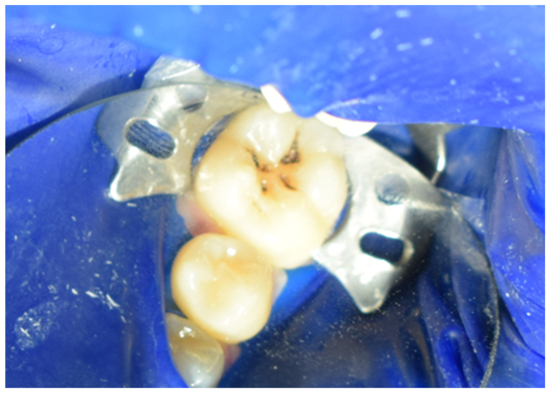 Direct and Semi-Direct Composite Techniques in Posterior Teeth: A Two ...