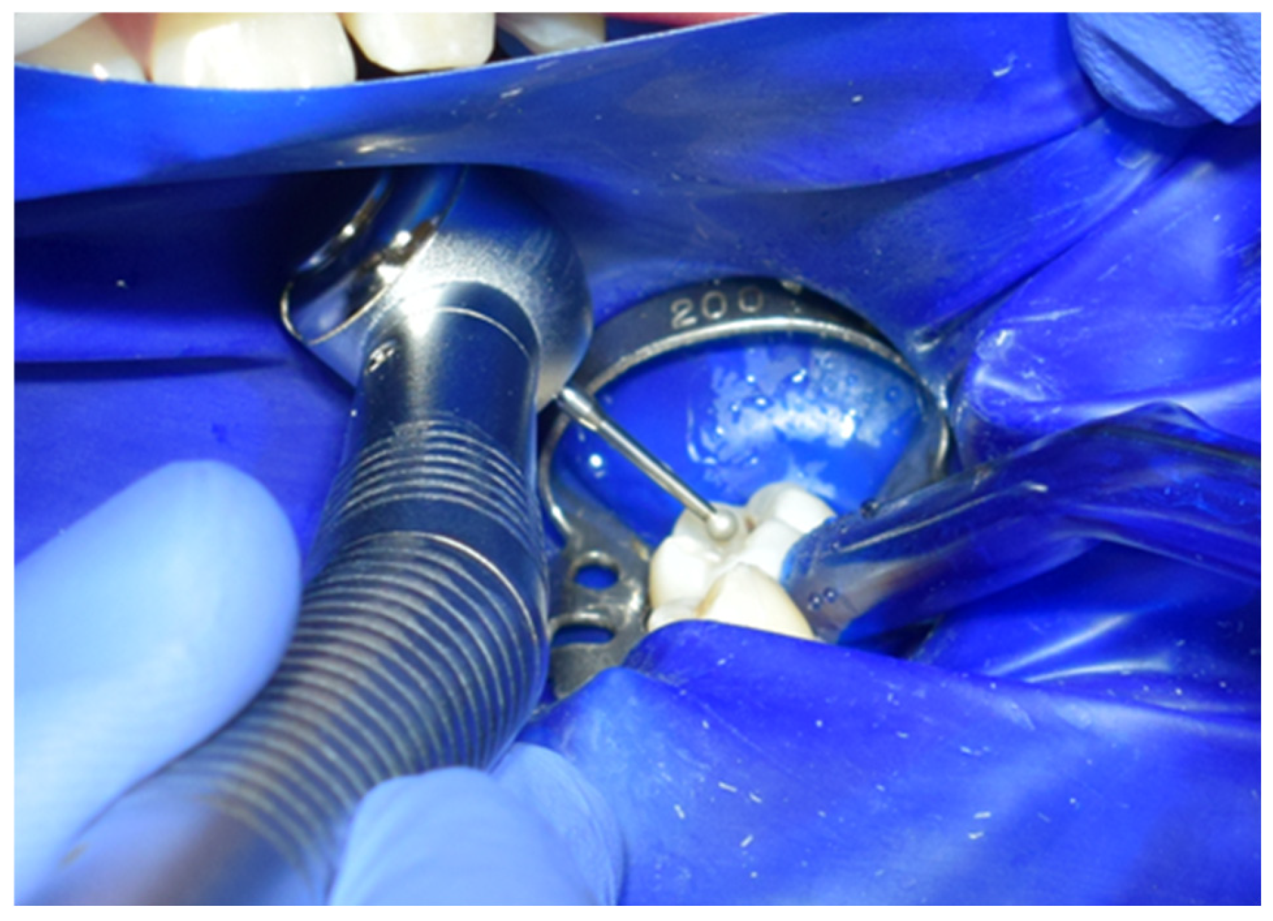 Direct and Semi-Direct Composite Techniques in Posterior Teeth: A Two ...