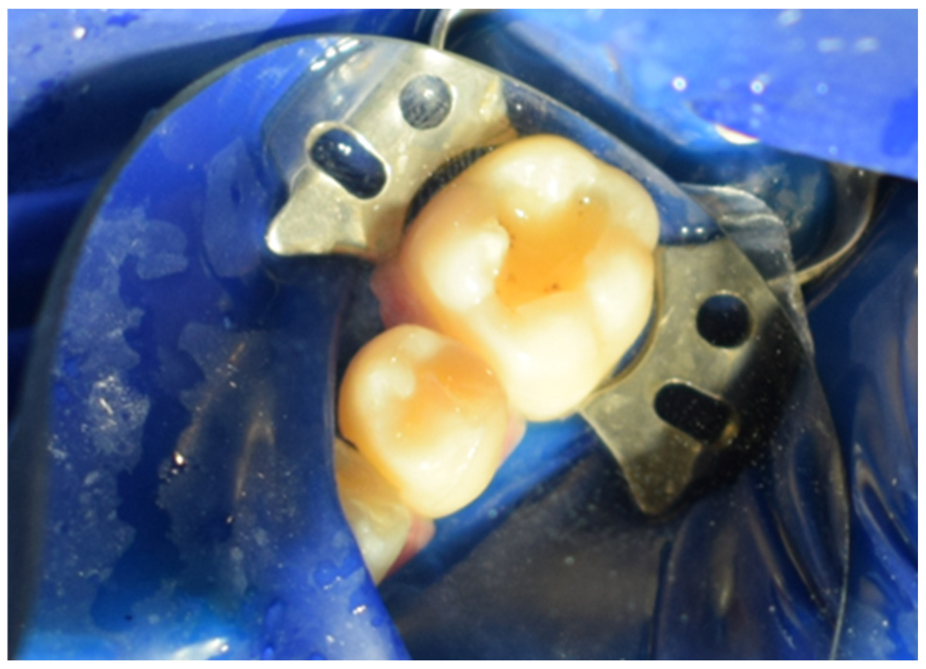 Direct and Semi-Direct Composite Techniques in Posterior Teeth: A Two ...