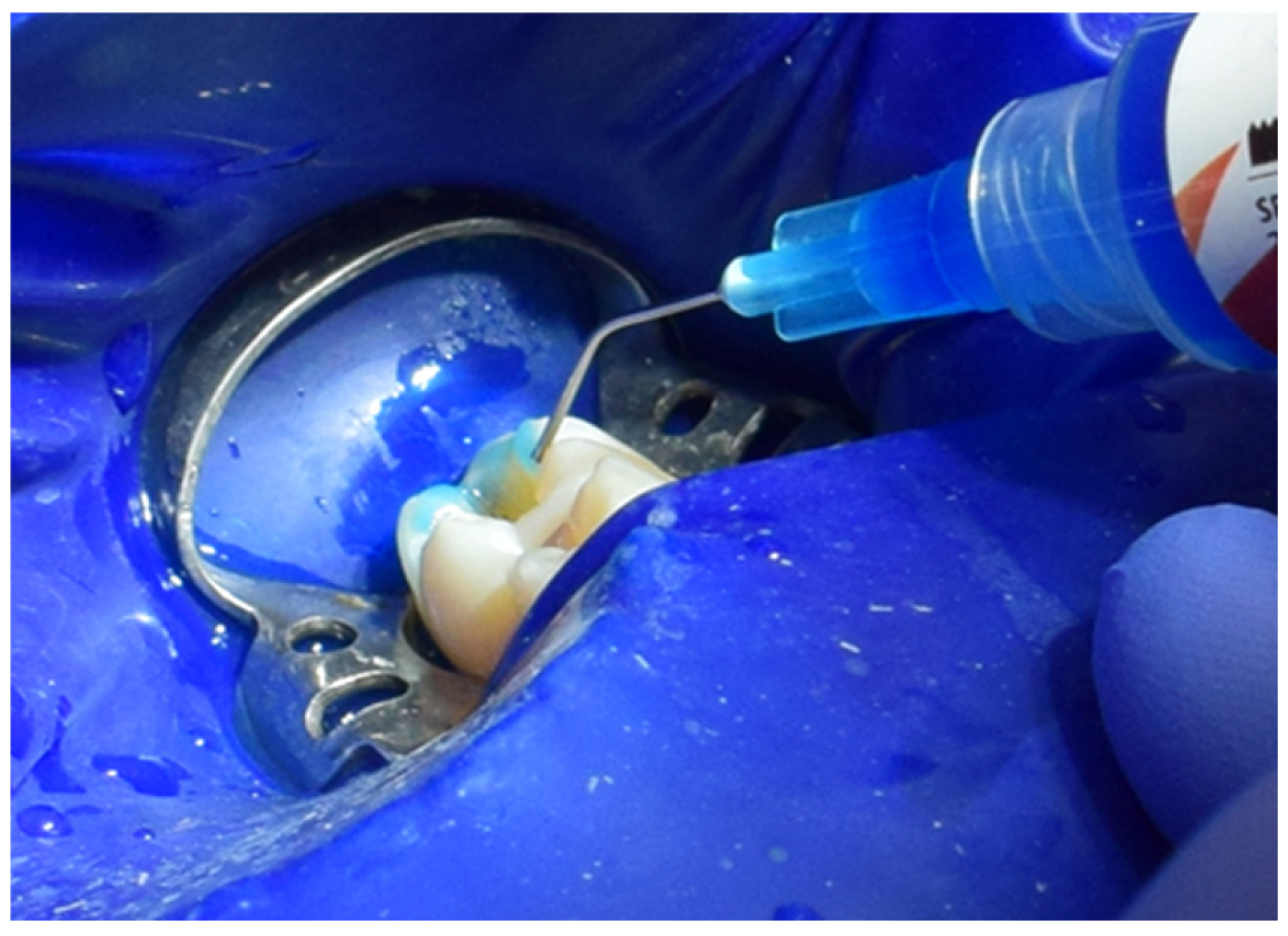 Direct and Semi-Direct Composite Techniques in Posterior Teeth: A Two ...