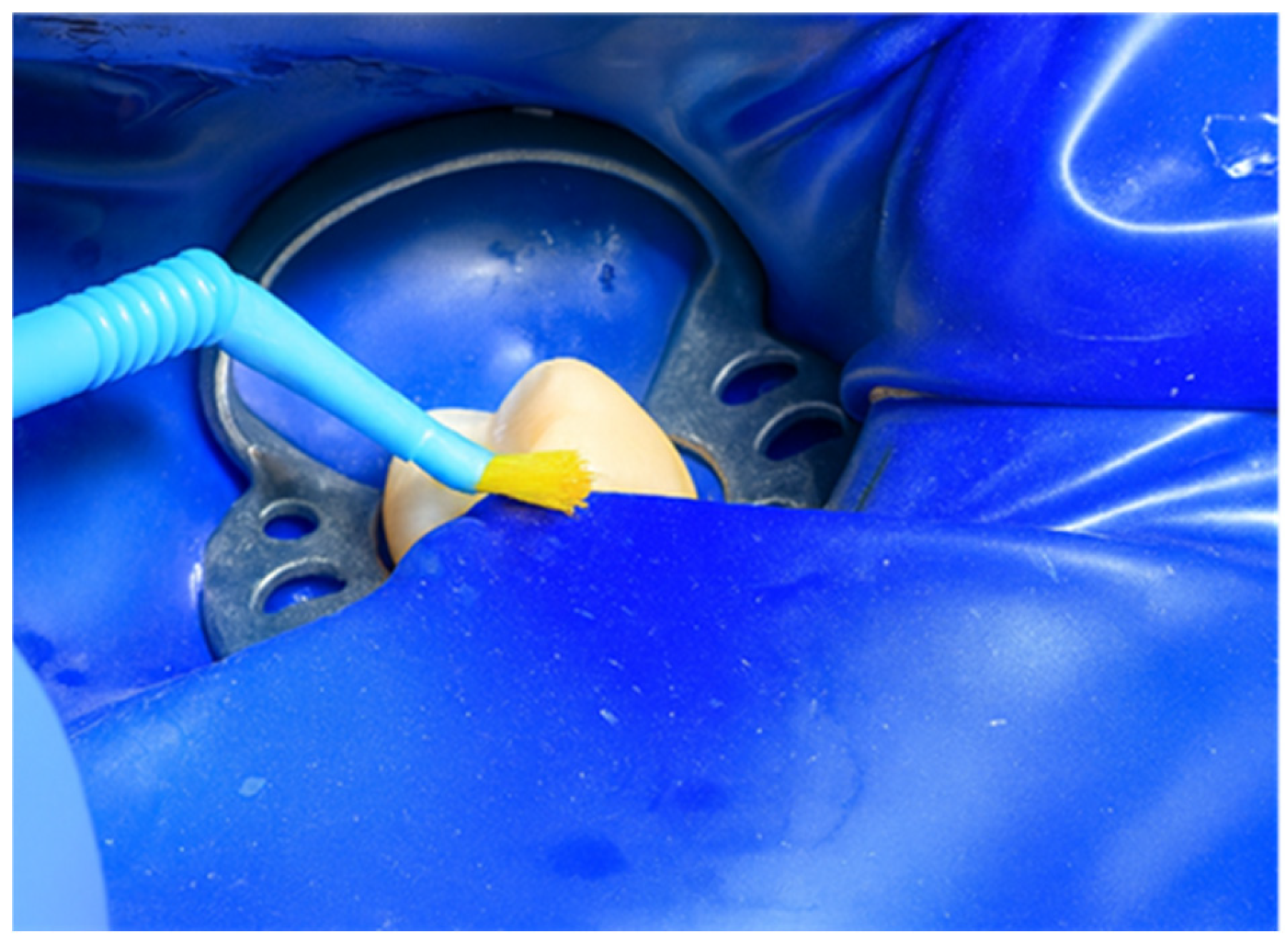 Direct and Semi-Direct Composite Techniques in Posterior Teeth: A Two ...