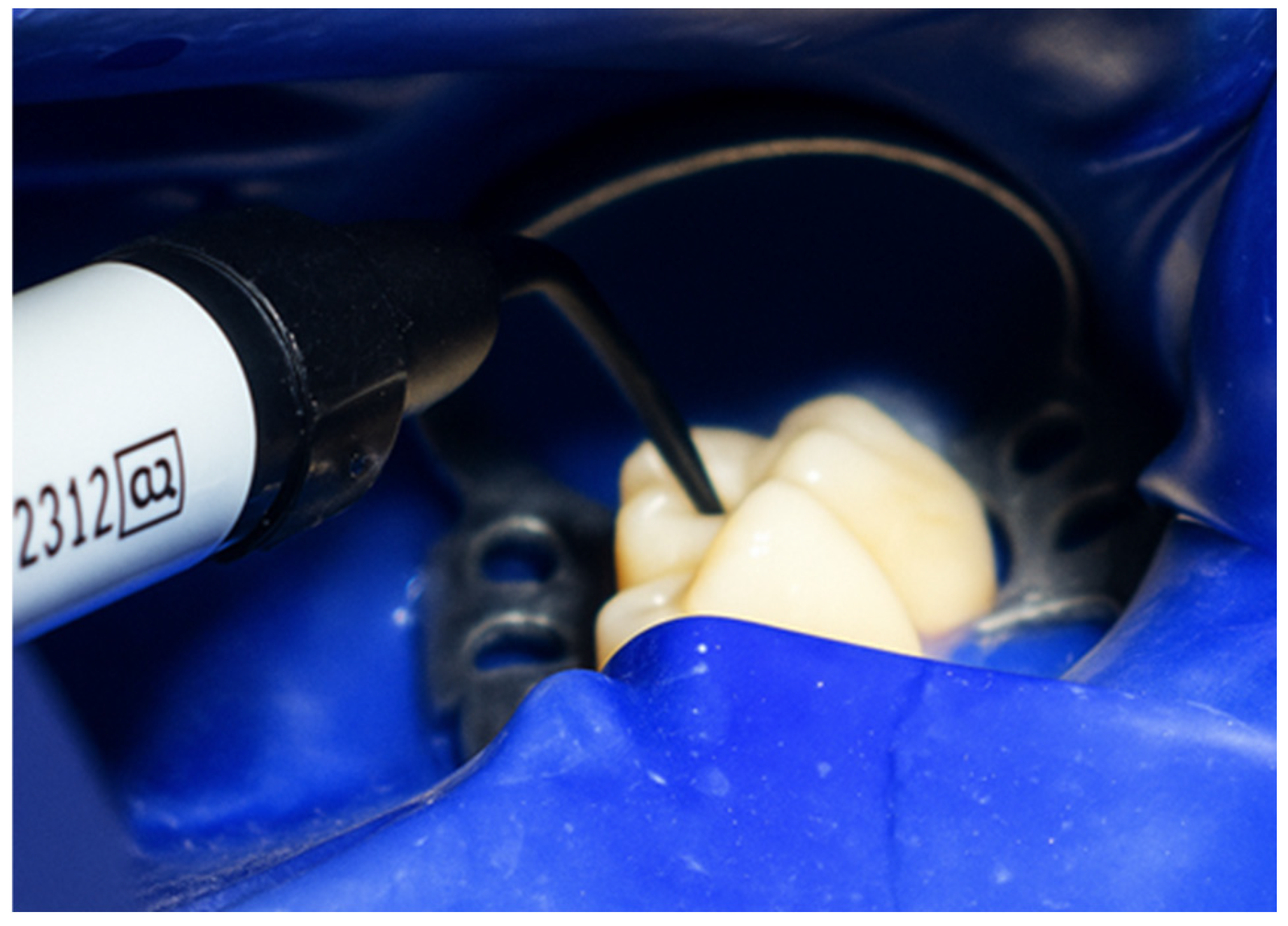 Direct and Semi-Direct Composite Techniques in Posterior Teeth: A Two ...
