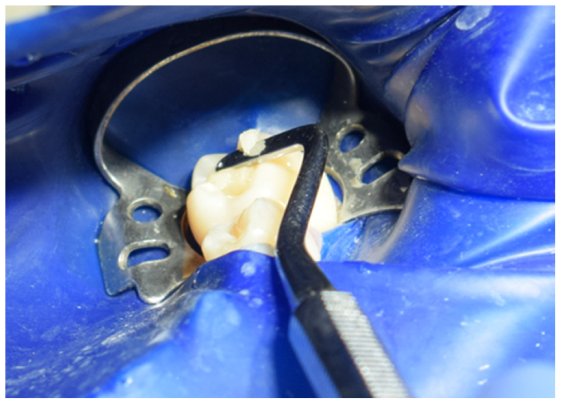 Direct and Semi-Direct Composite Techniques in Posterior Teeth: A Two ...