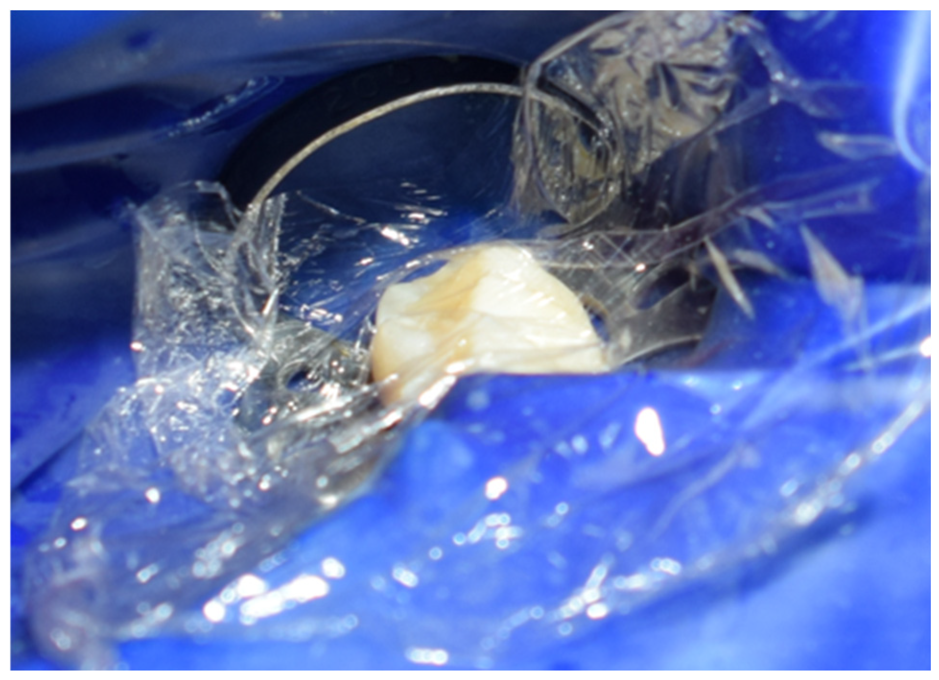 Direct and Semi-Direct Composite Techniques in Posterior Teeth: A Two ...