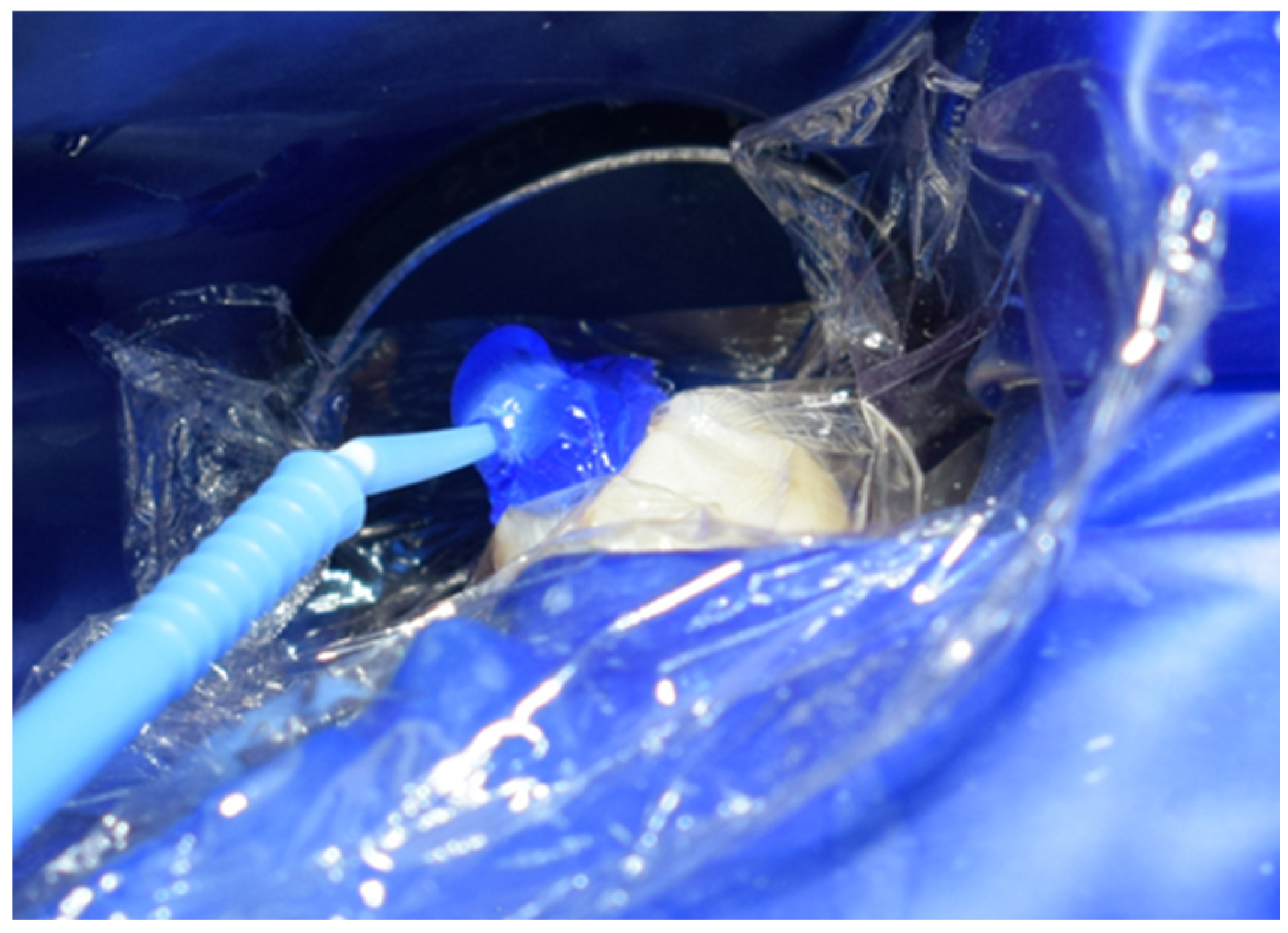 Direct and Semi-Direct Composite Techniques in Posterior Teeth: A Two ...