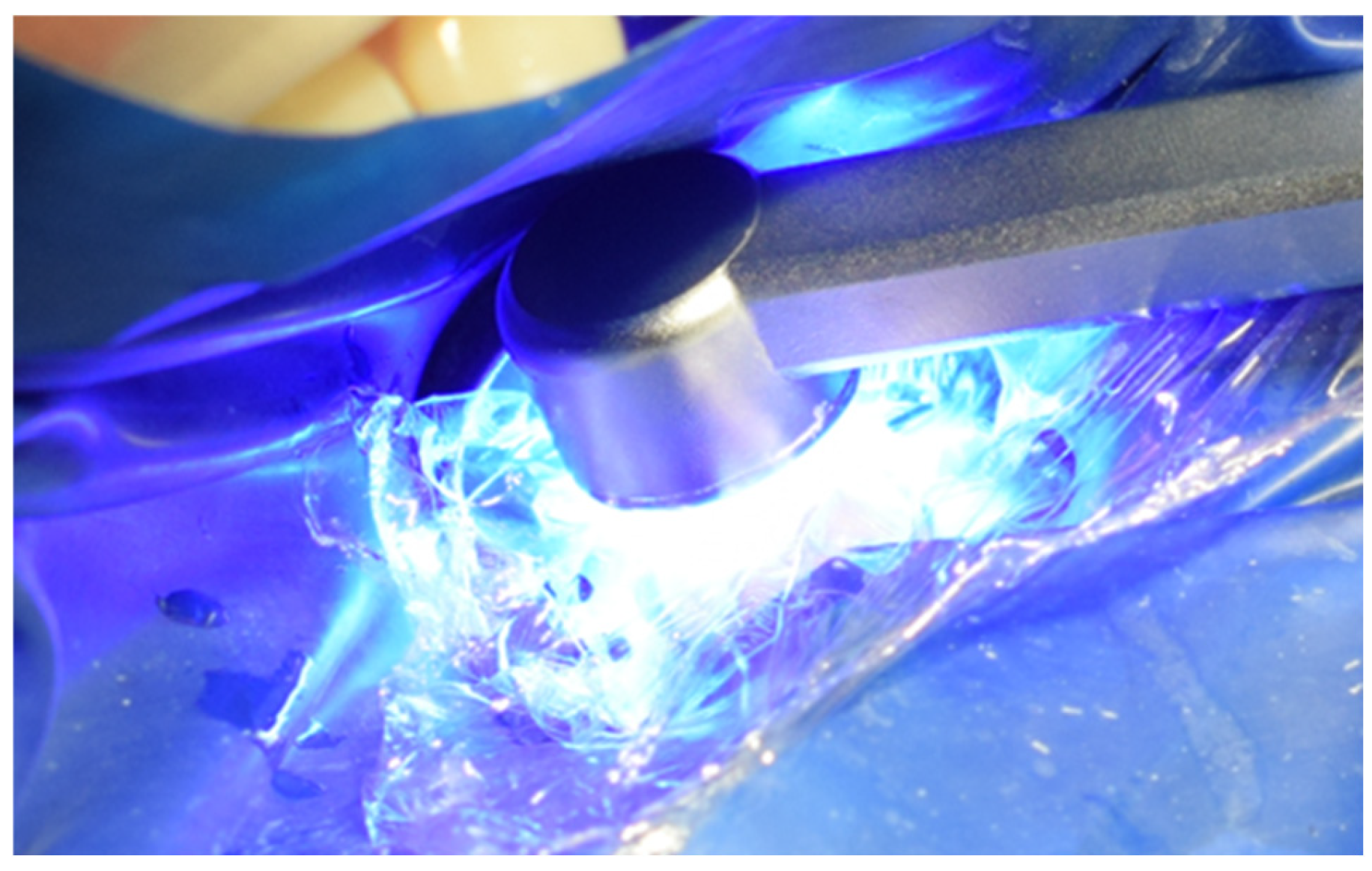 Direct and Semi-Direct Composite Techniques in Posterior Teeth: A Two ...
